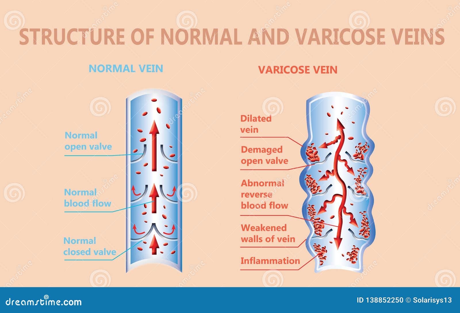 Varicose Veins on a Female Senior Legs. the Structure of Normal and ...
