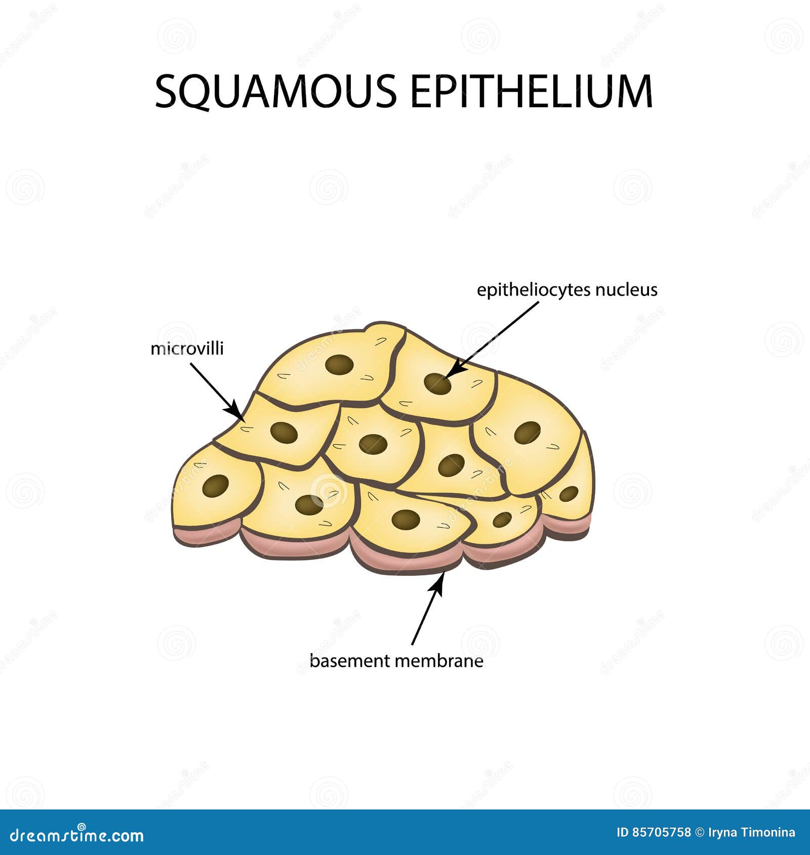 Section Of Squamous Epithelioma, Vintage Engraving Cartoon Vector ...