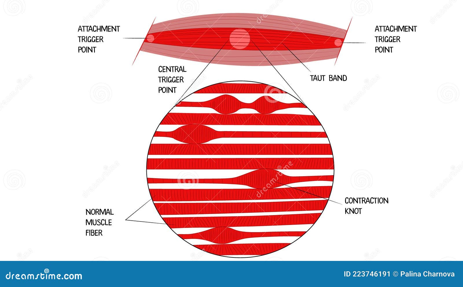 The Structure Of The Trigger Point In The Muscle Attachment Trigger Point Taut Band