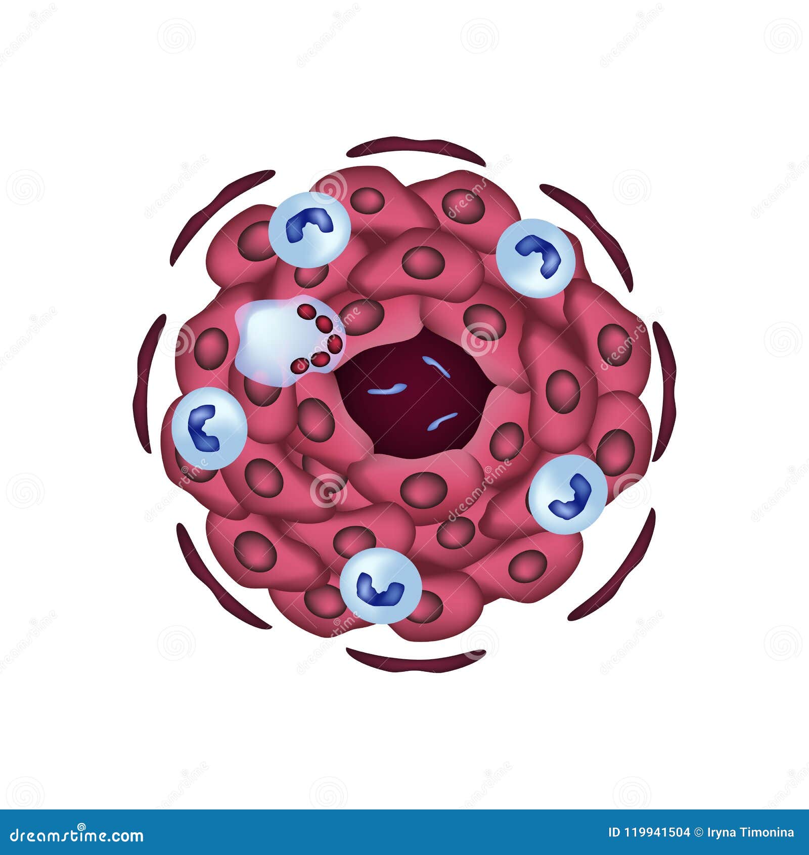 The Structure of Tuberculous Granulomas. Vector Illustration on ...