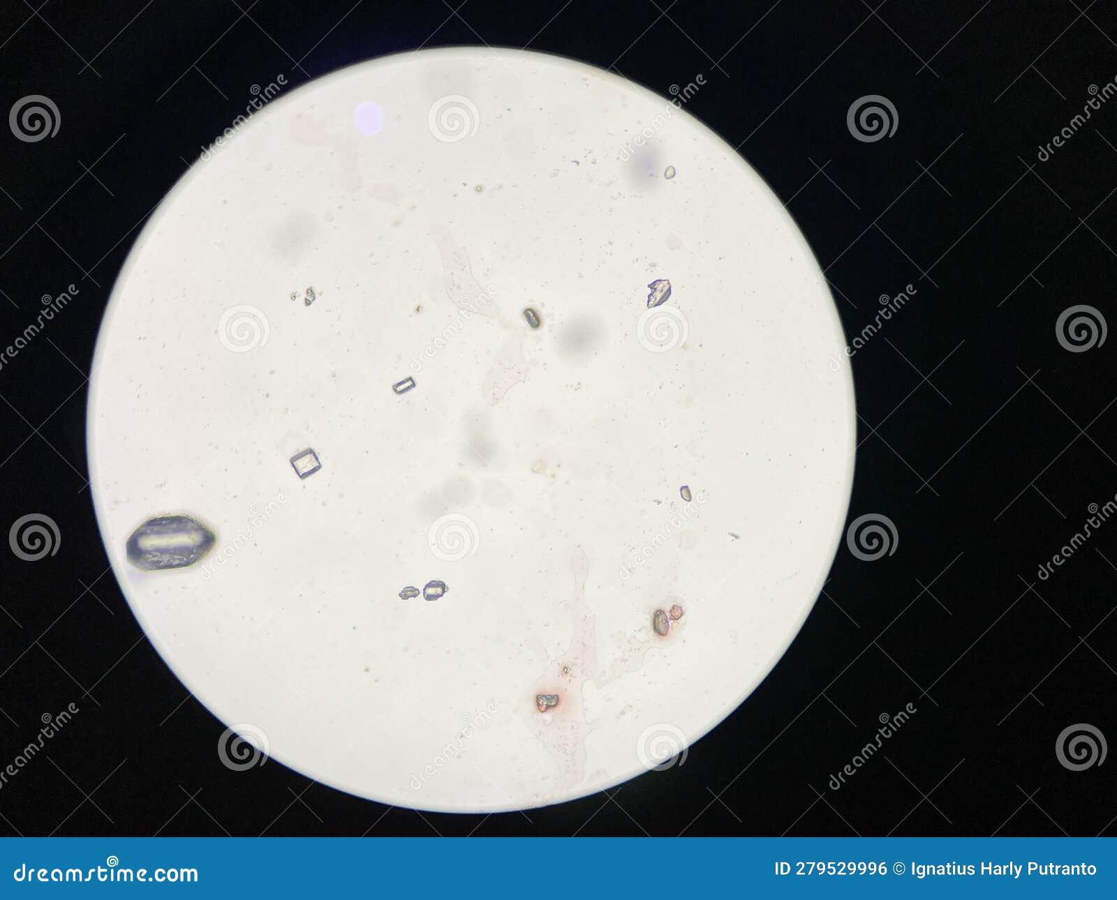 Cholesterol Crystals Under A Microscope Royalty-Free Stock Image ...