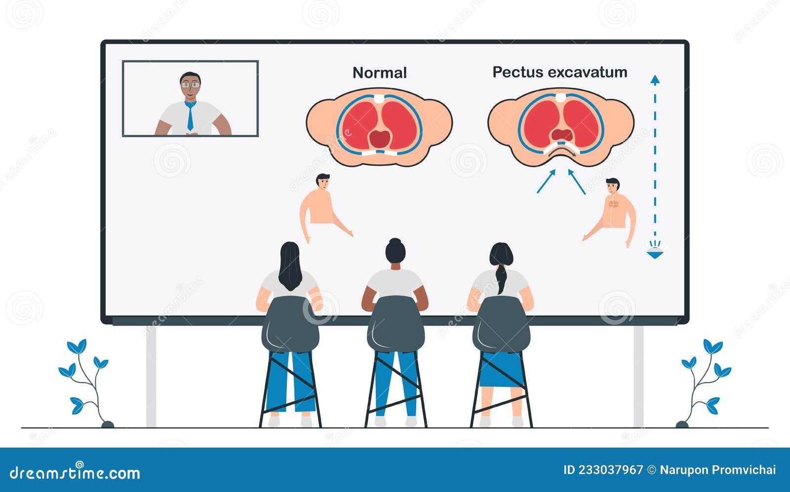 Pectus Excavatum Is A Structural Deformity Of Anterior Thoracic Wall ...