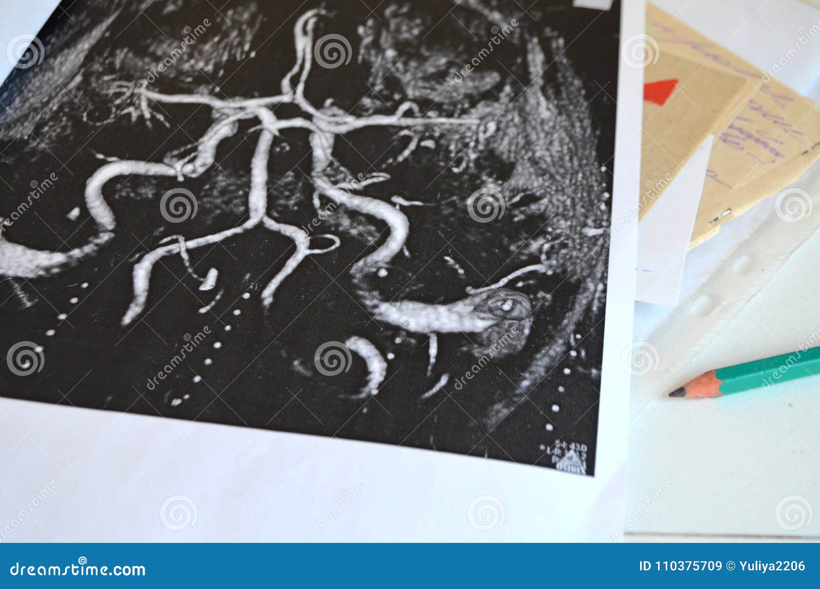 Study of the Brain after a Stroke - Neuron Stock Image - Image of close ...