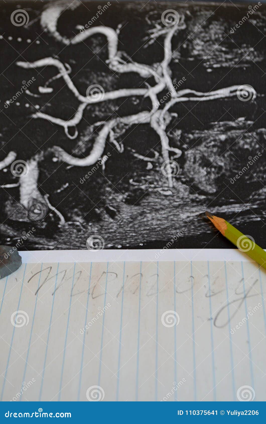 Study of the Brain after a Stroke - Neuron Stock Image - Image of ...