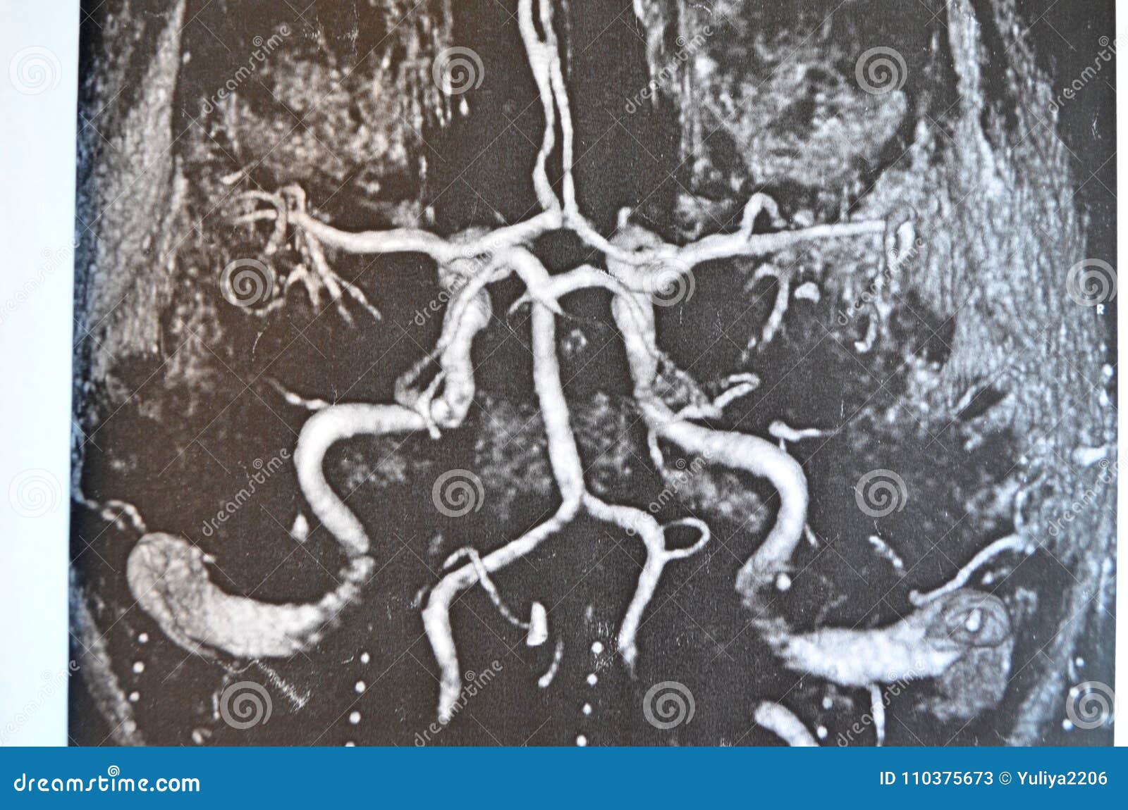 Study of the Brain after a Stroke - Neuron Stock Image - Image of ...