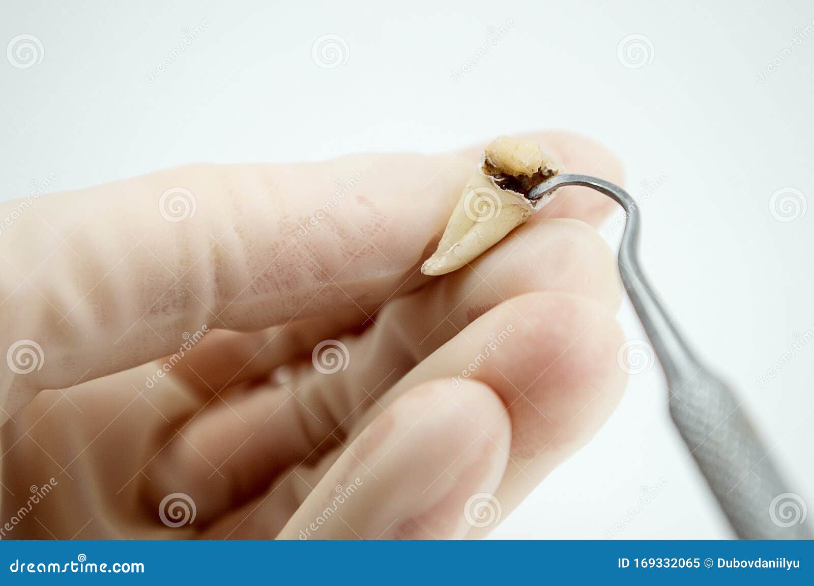 Study of the Carious Cavity of the Destroyed Caries Tooth Stock Image ...