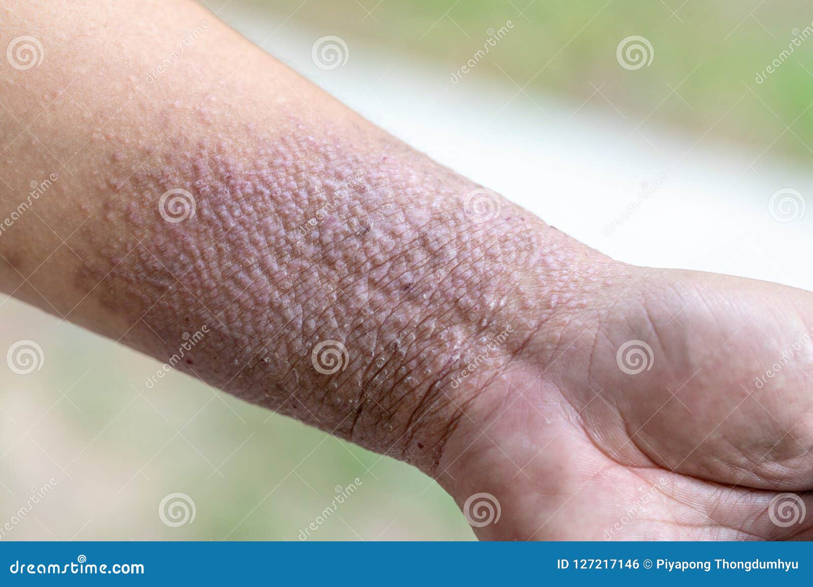 Study of Physical of Atopic Dermatitis AD, Also Known As Atopic Eczema ...