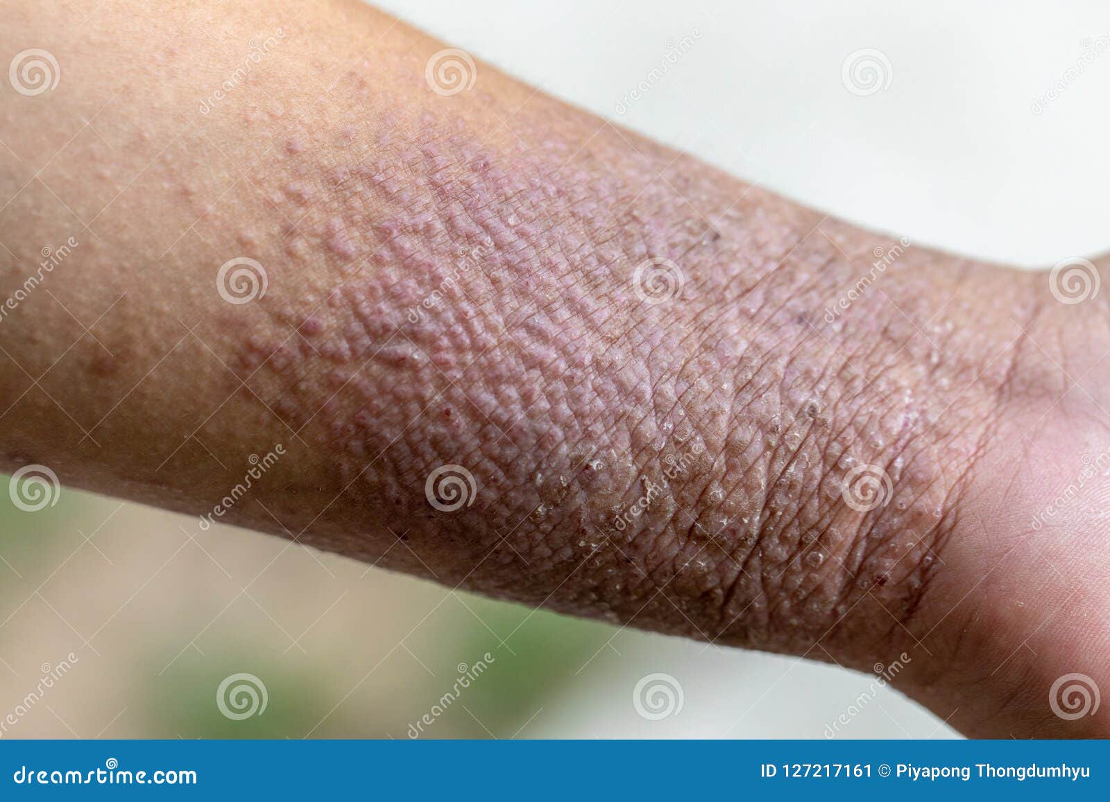 A Physical Of Atopic Dermatitis AD, Also Known As Atopic Eczema Royalty ...