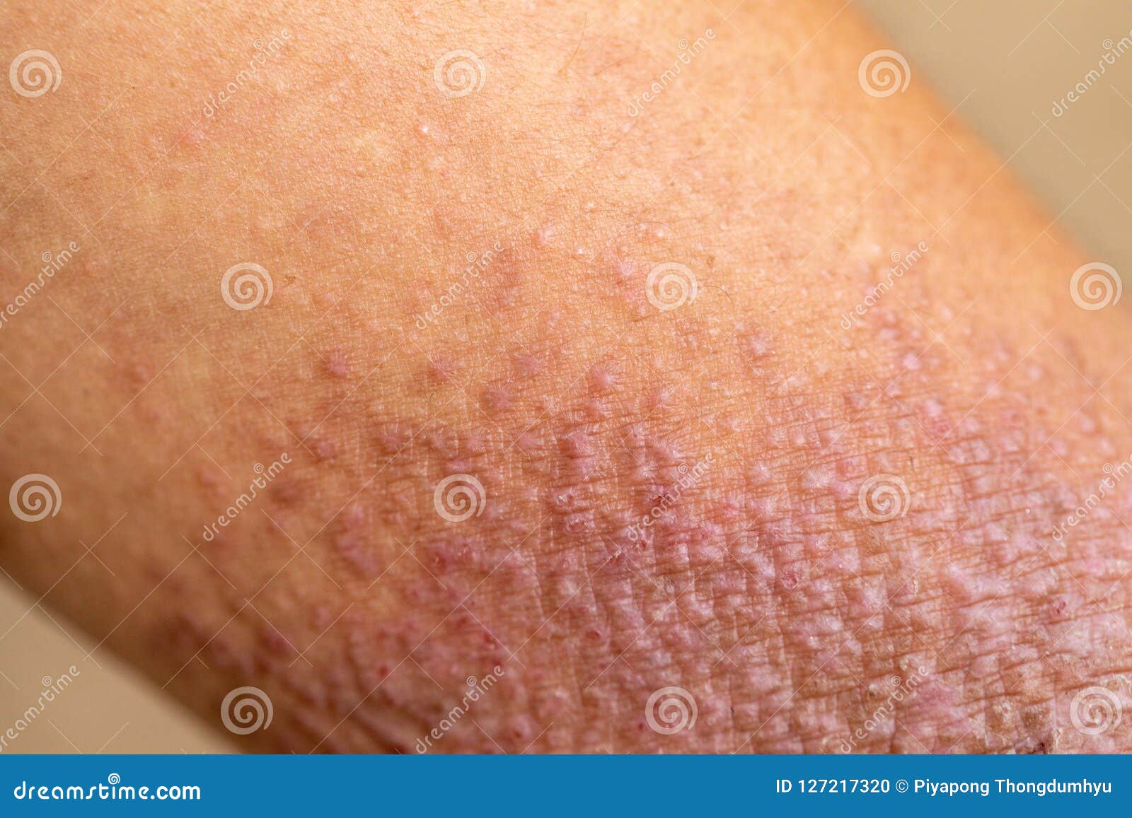 Study of Physical of Atopic Dermatitis AD, Also Known As Atopic Eczema ...