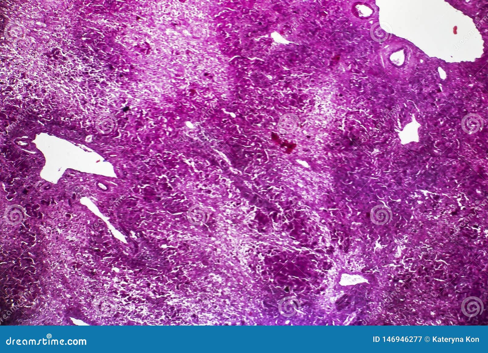Subacute Severe Hepatitis, Light Micrograph Stock Image | CartoonDealer ... Subacute Severe Hepatitis, Light Micrograph Stock Image | CartoonDealer ...