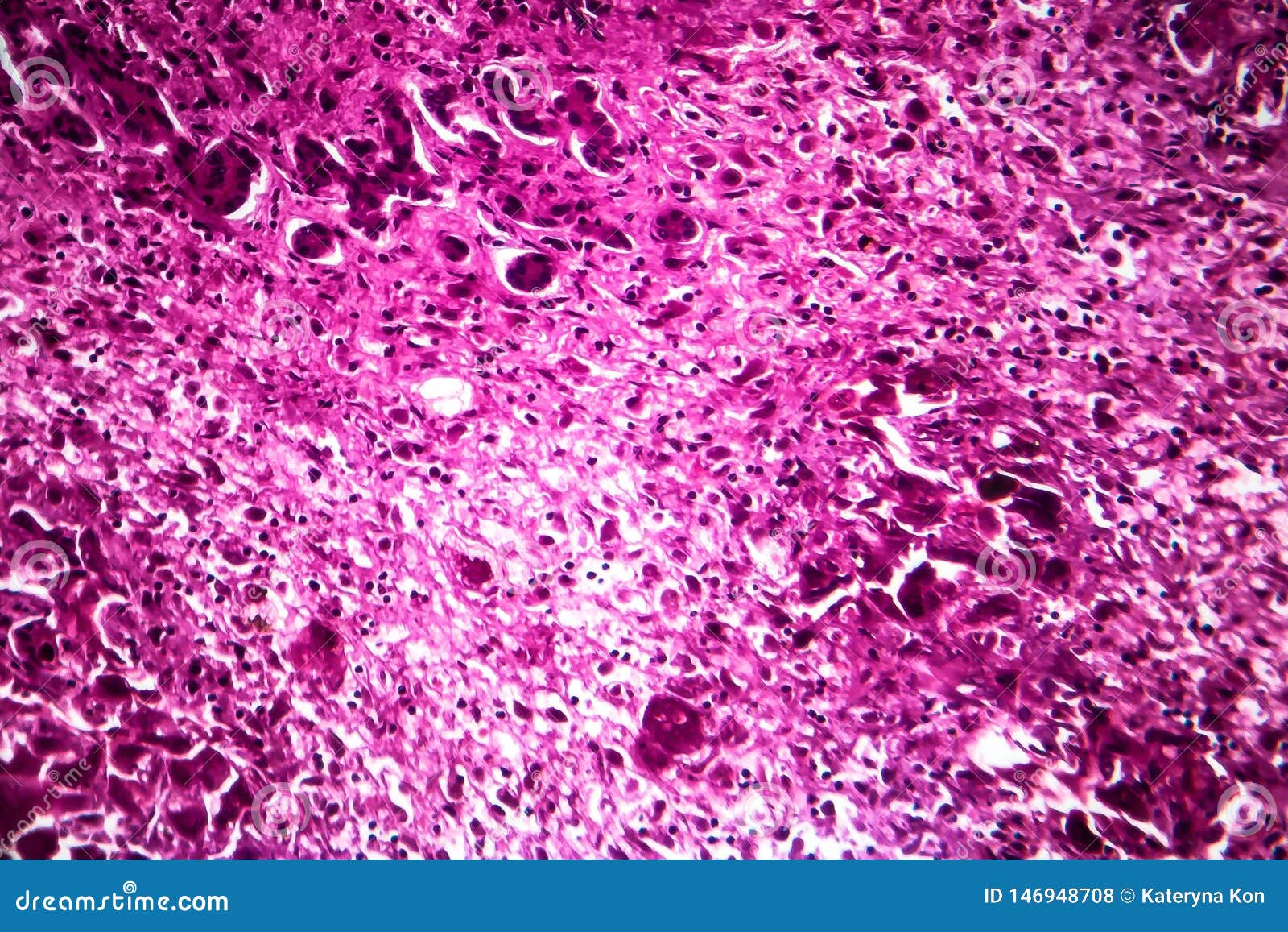 Subacute Severe Hepatitis, Light Micrograph Stock Photography ... Subacute Severe Hepatitis, Light Micrograph Stock Photography ...