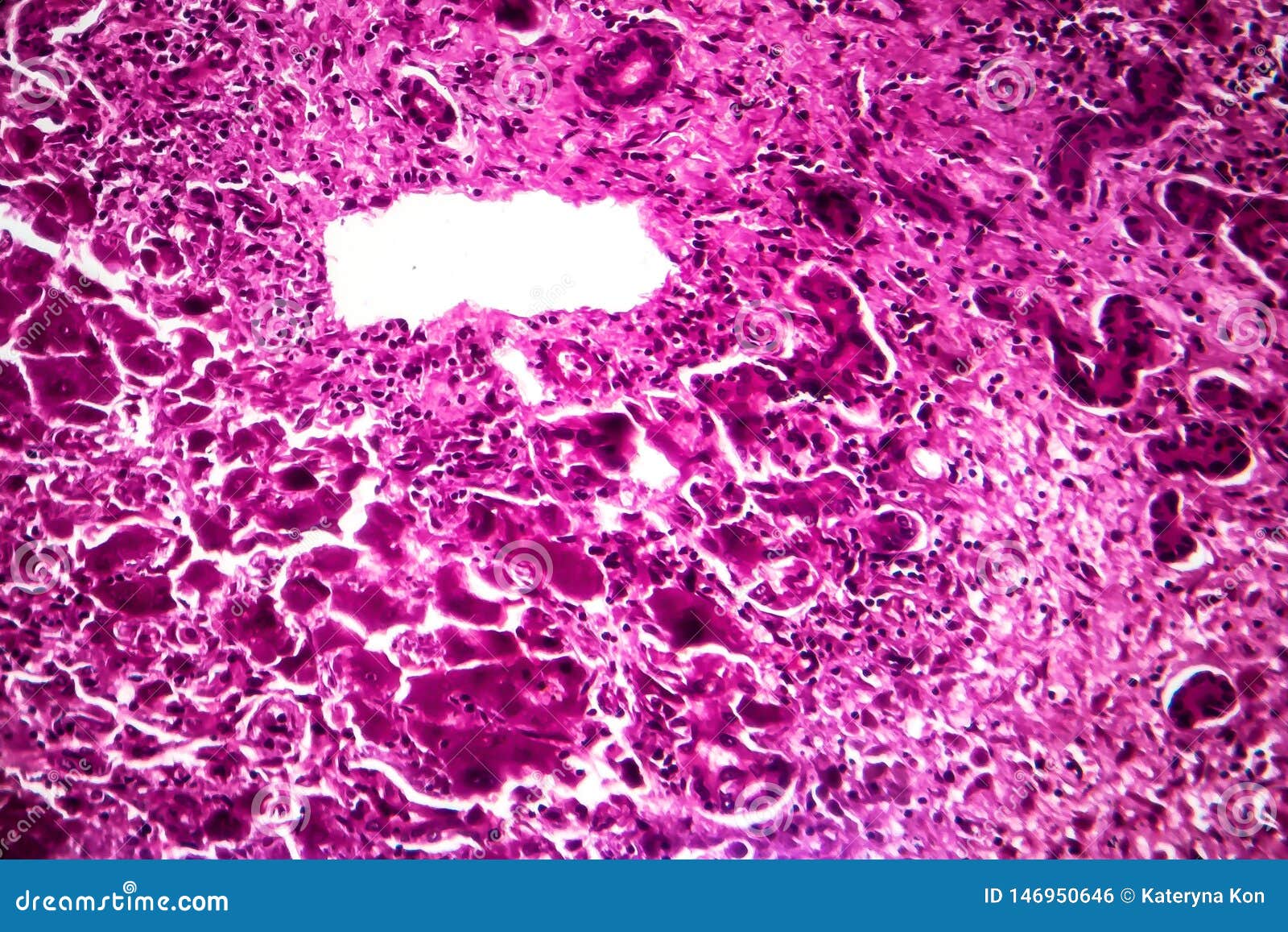 Subacute Severe Hepatitis, Light Micrograph Stock Photography ... Subacute Severe Hepatitis, Light Micrograph Stock Photography ...