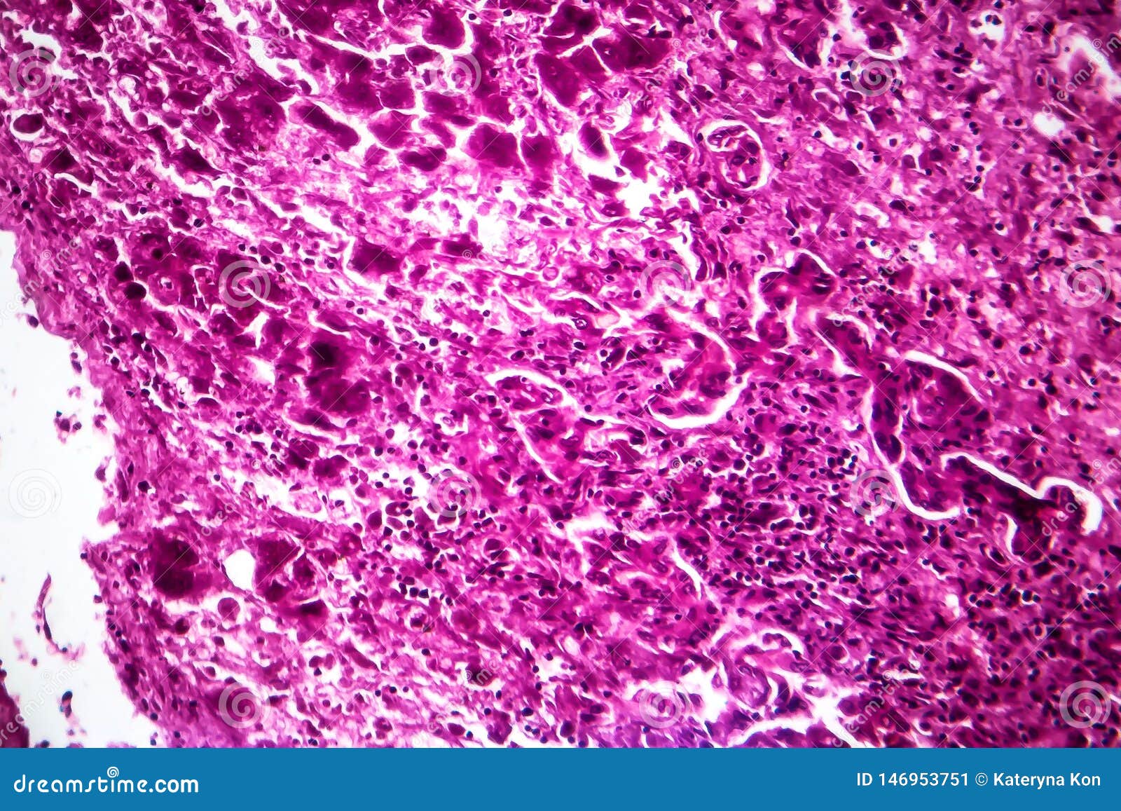 Subacute Severe Hepatitis, Light Micrograph Stock Photography ... Subacute Severe Hepatitis, Light Micrograph Stock Photography ...