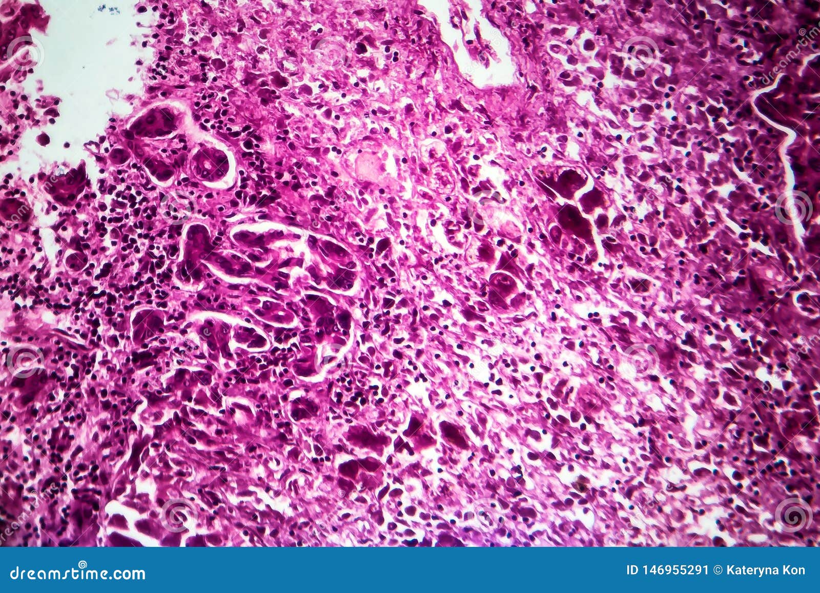 Subacute Severe Hepatitis, Light Micrograph Stock Photography ... Subacute Severe Hepatitis, Light Micrograph Stock Photography ...