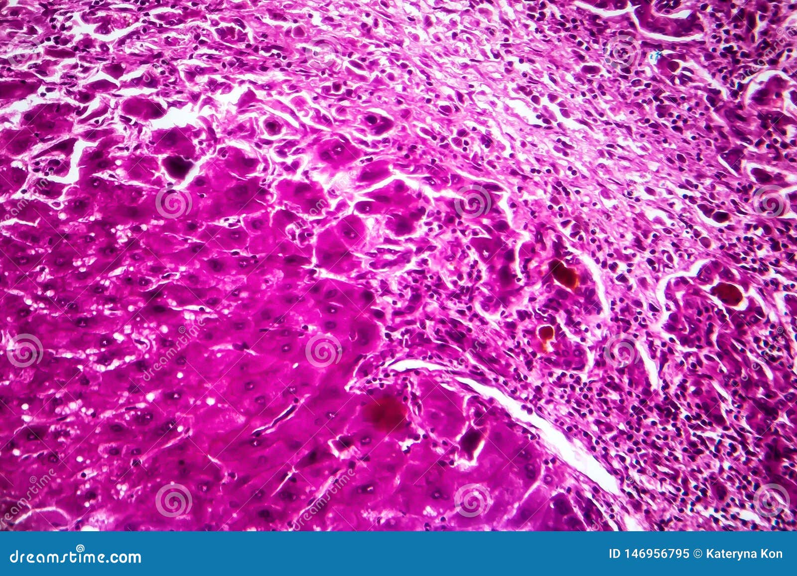 Subacute Severe Hepatitis, Light Micrograph Stock Illustration ...