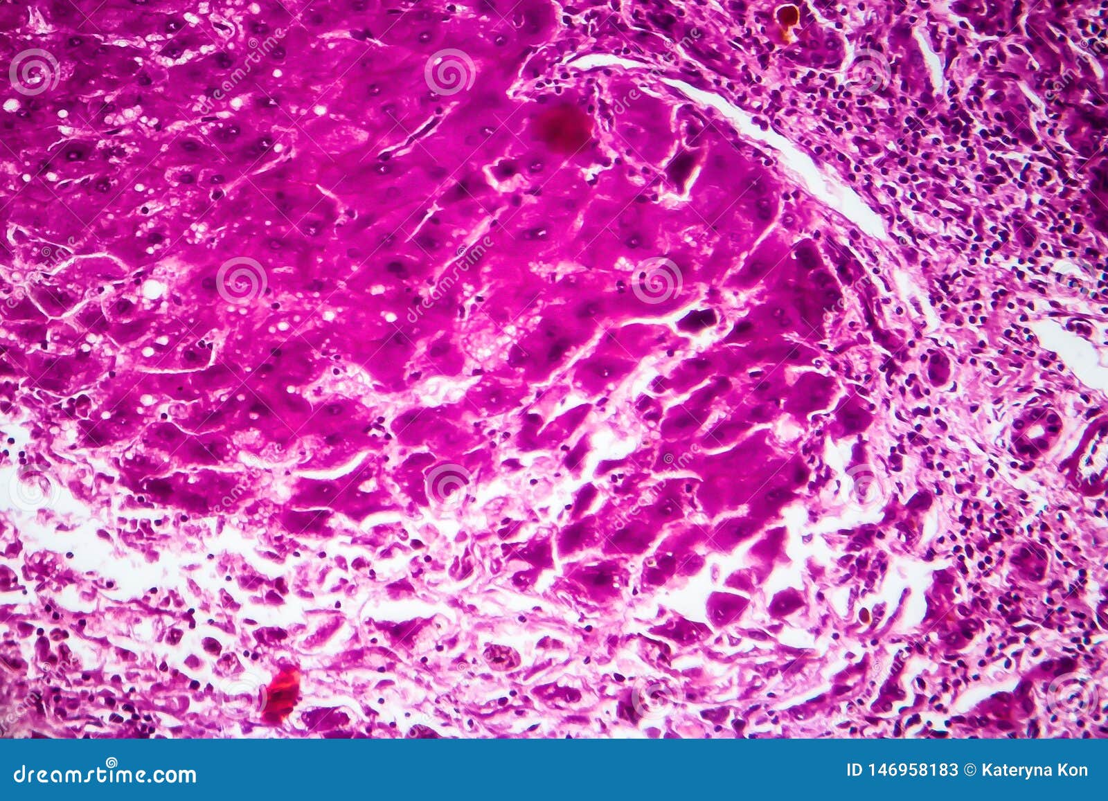 Subacute Severe Hepatitis, Light Micrograph Stock Image | CartoonDealer ... Subacute Severe Hepatitis, Light Micrograph Stock Image | CartoonDealer ...