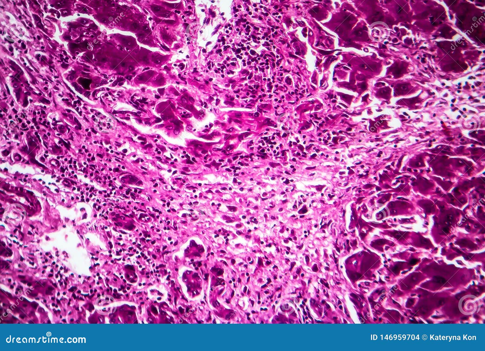 Subacute Severe Hepatitis, Light Micrograph Stock Illustration ...
