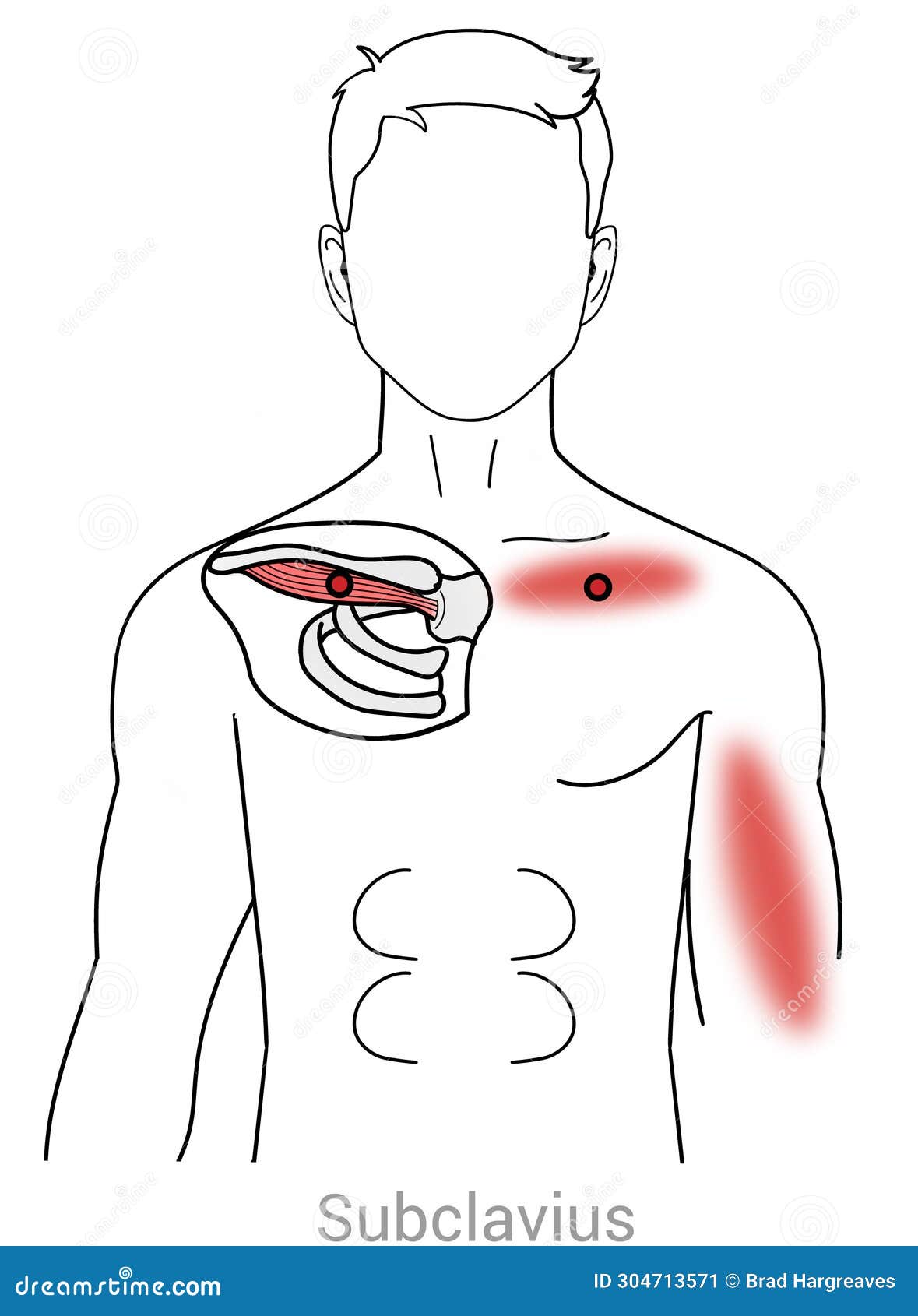 Subclavius: Managing Chest And Arm Pain Originating From Myofascial ...