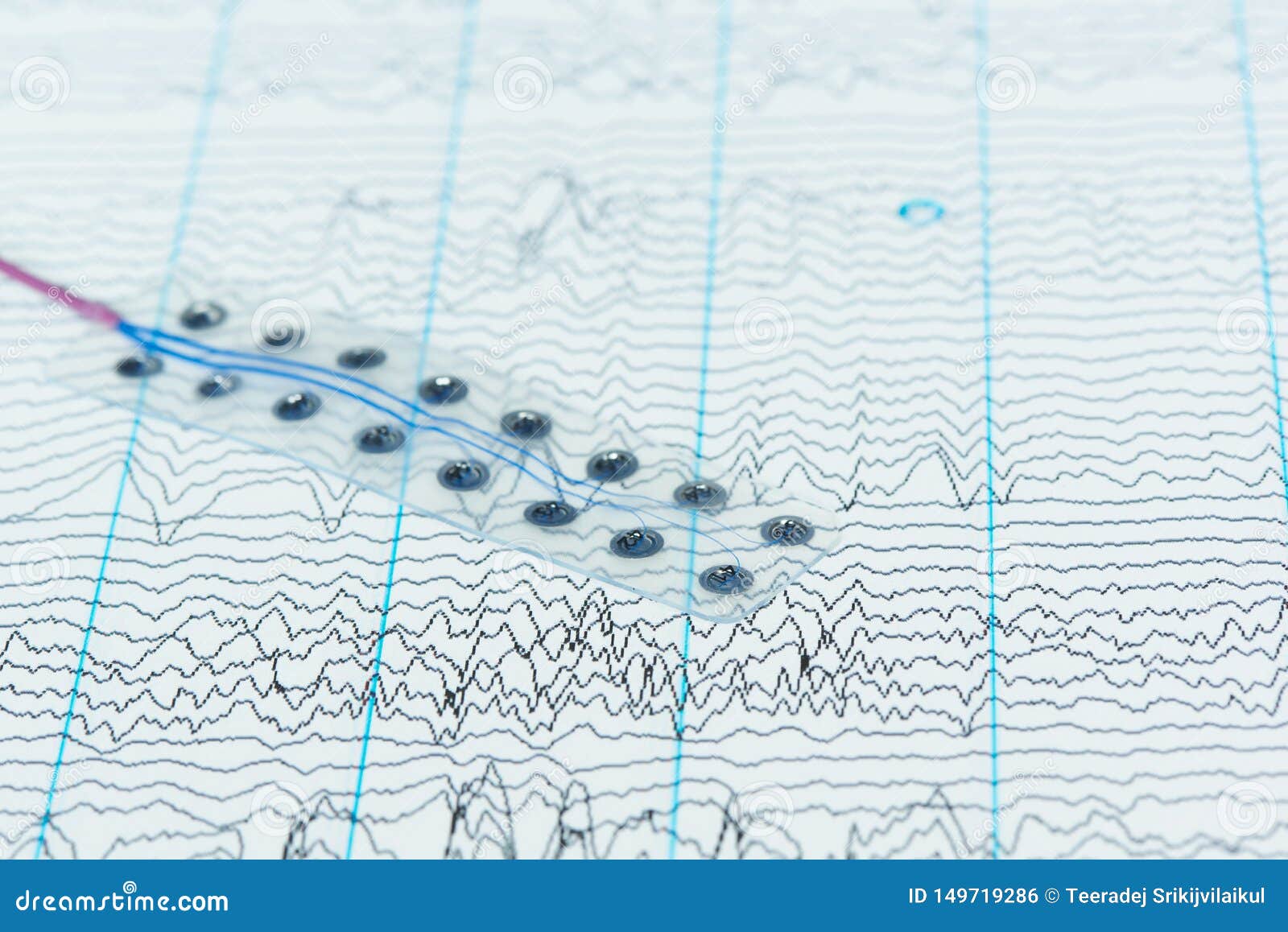 Subdural Electrode For Brain Waves Monitoring In Epilepsy Surgery ...