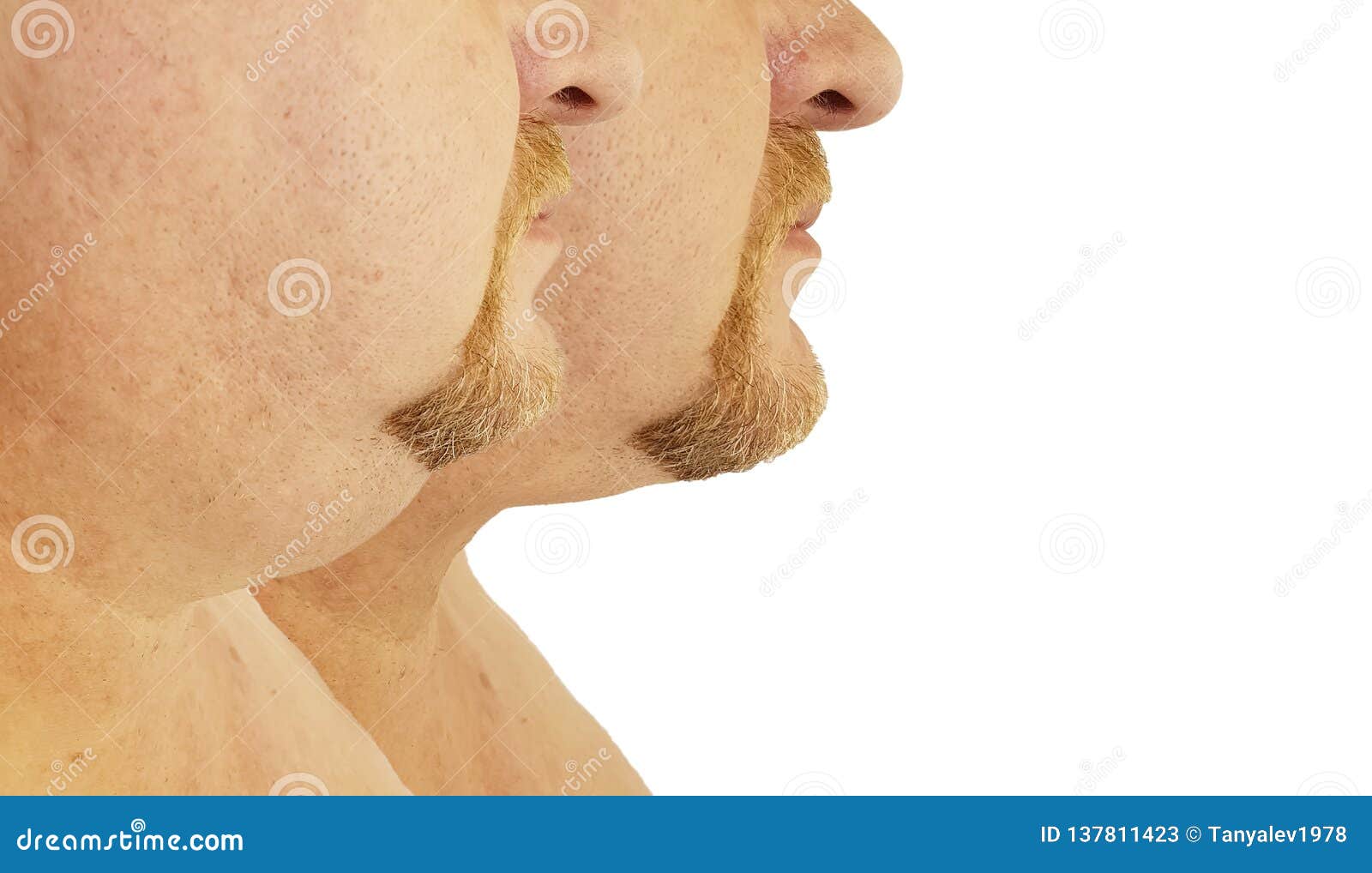 Submental Fat Man before and after, Procedures Stock Image - Image of ...