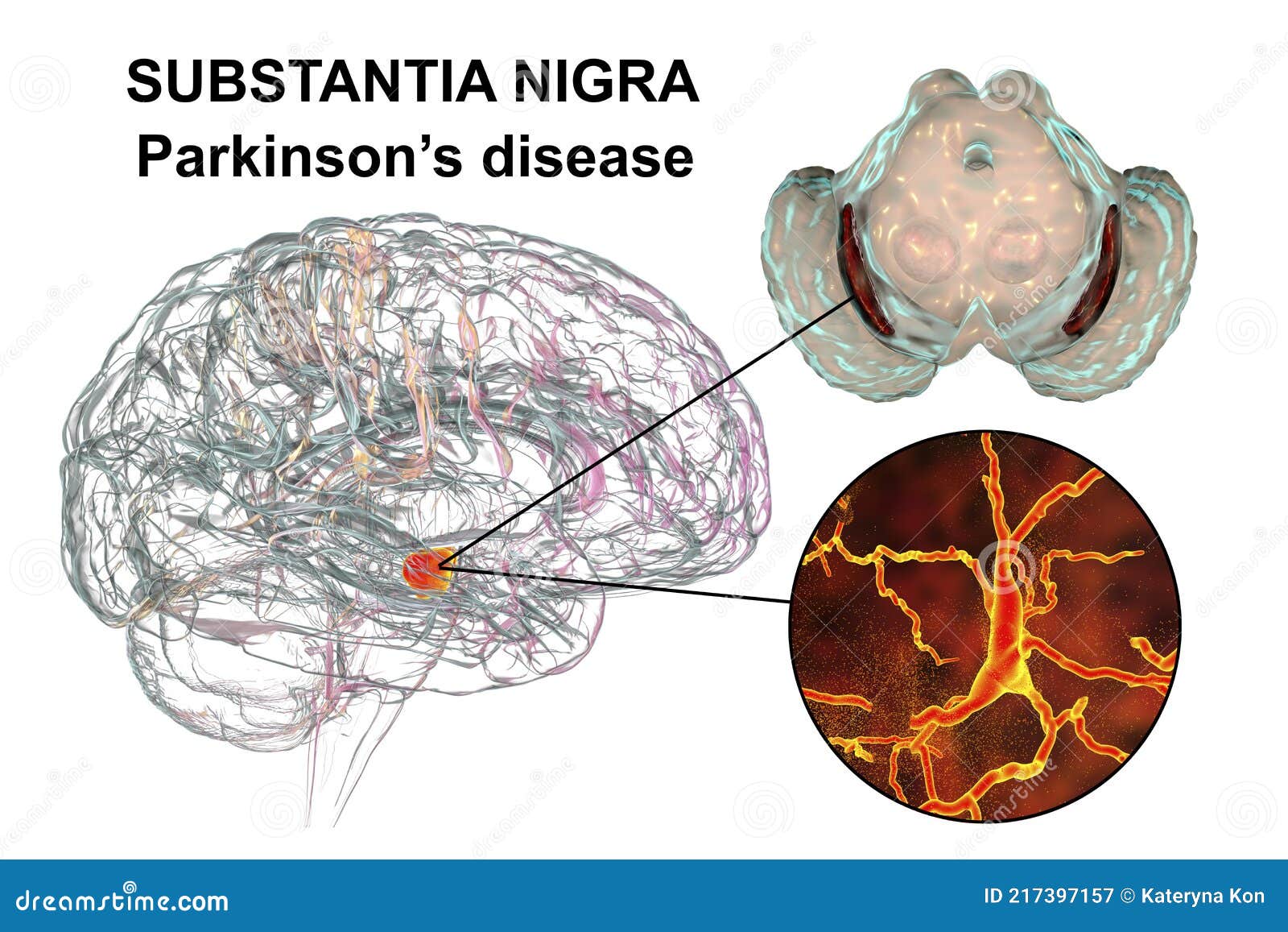 Corpus Striatum And Substantia Nigra