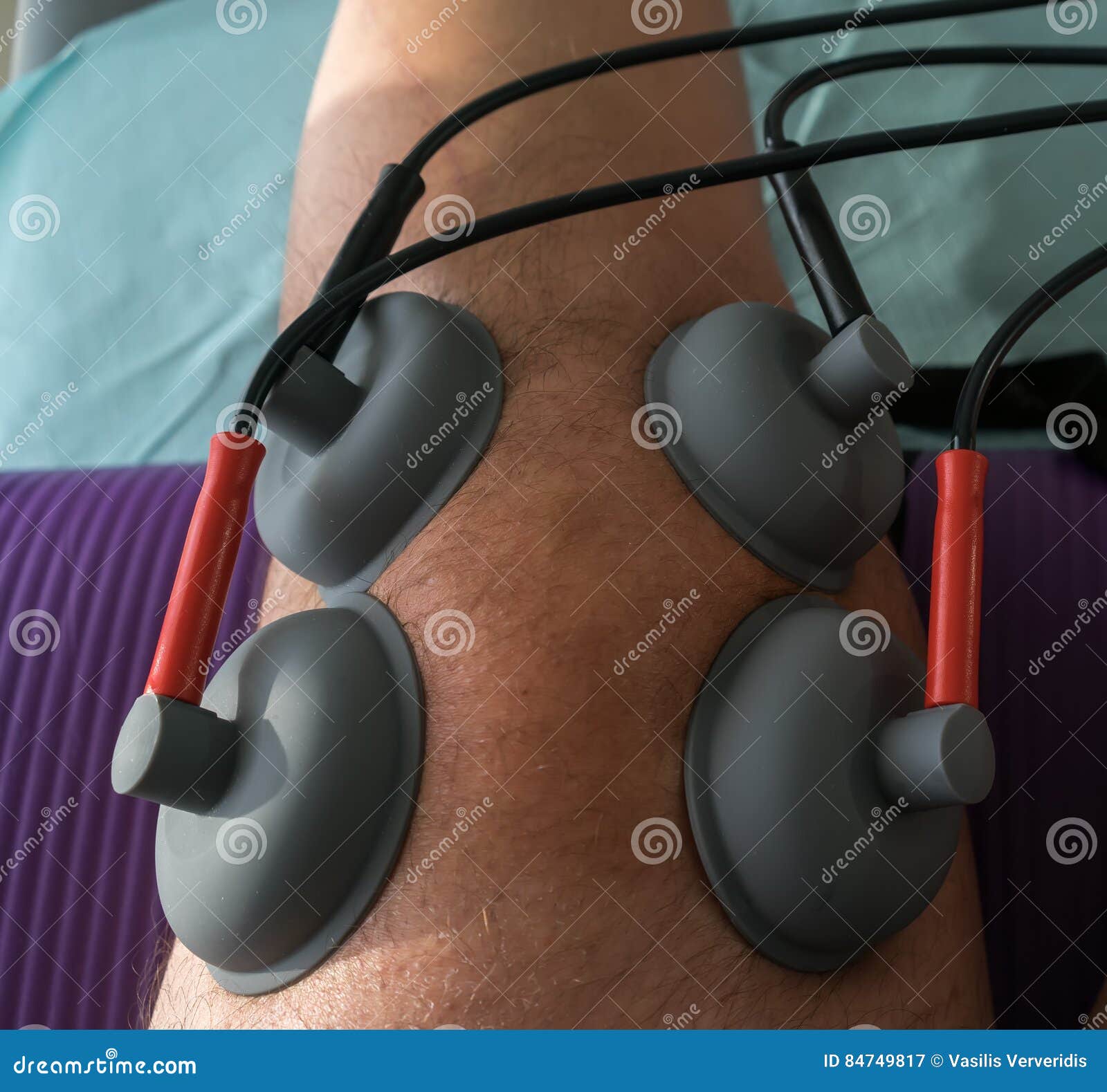 Suction Cups Applied To a Knee in Physiotherapy Stock Image - Image of ...