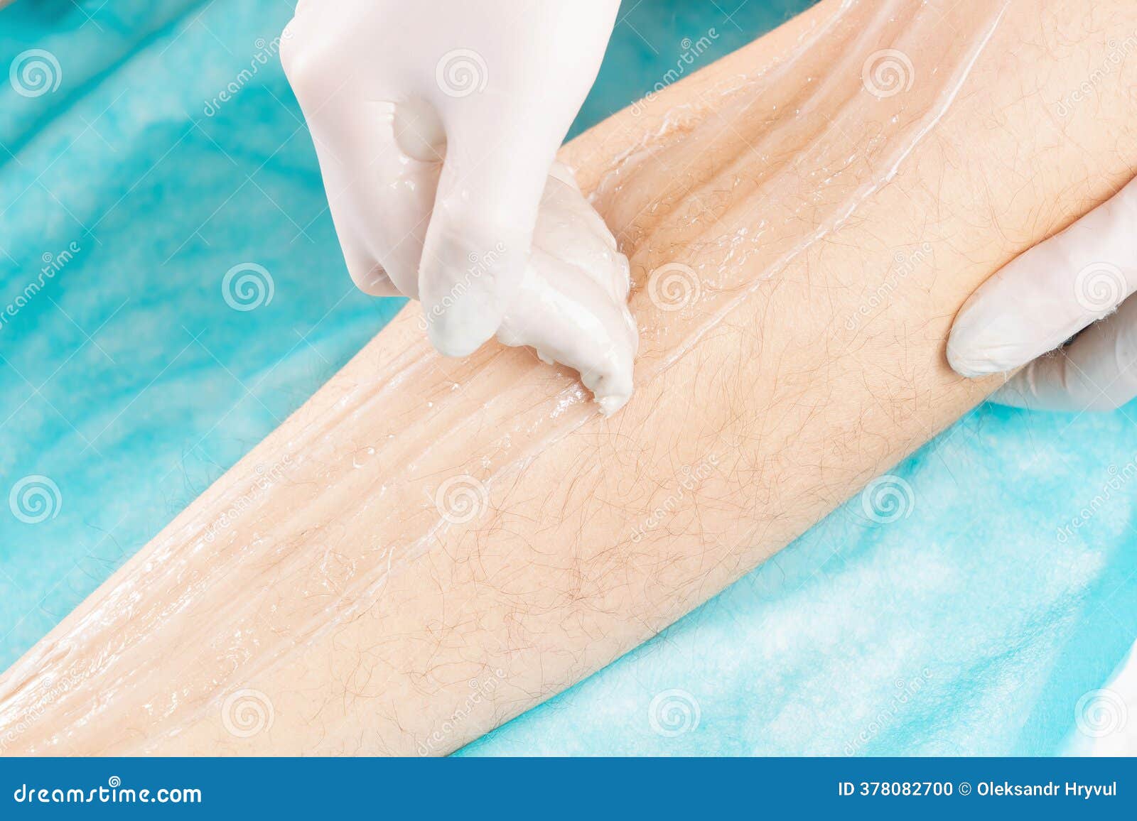 The Process Of Epilation Of The Legs Or Parts Of The Female Body Using ...