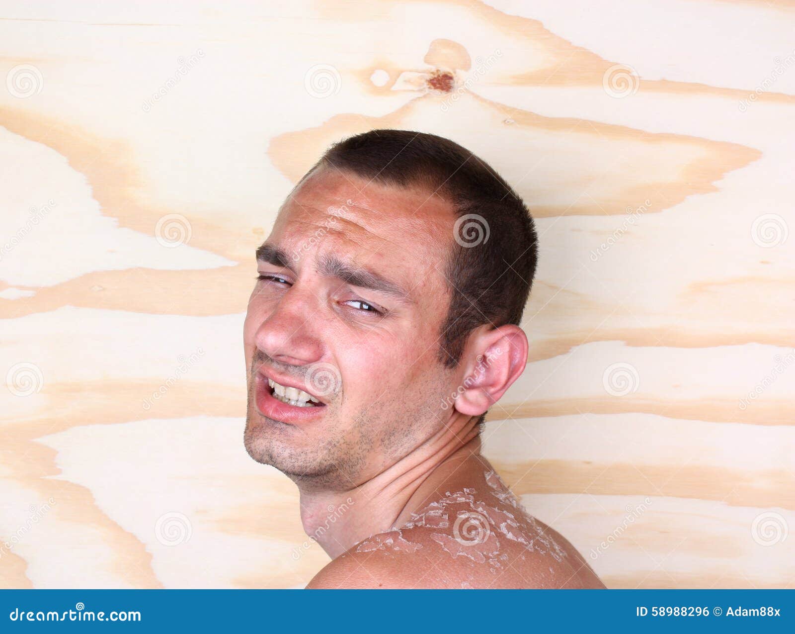 Sunburn On The Back And Neck Of A Man, Skin Peeling And Peeling, Red ...