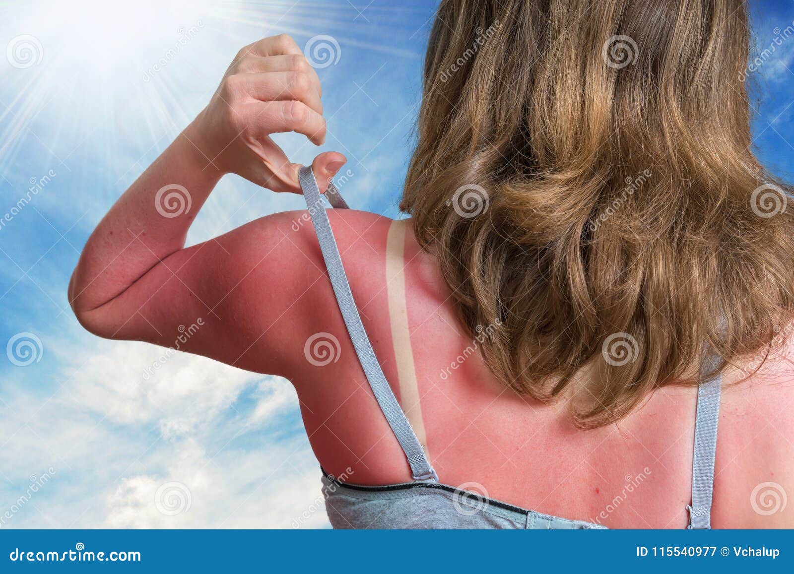 Sunburned Skin On Shoulder And Back Of A Woman Red Skin Sun Burn After