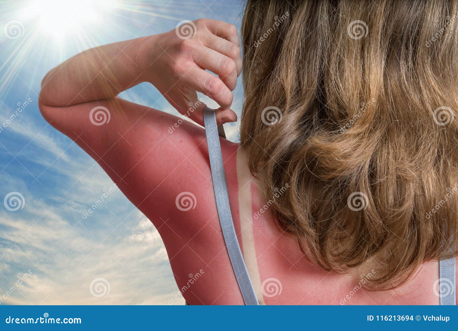 Sunburn Concept Young Woman With Red Sunburned Skin On Her Back Stock
