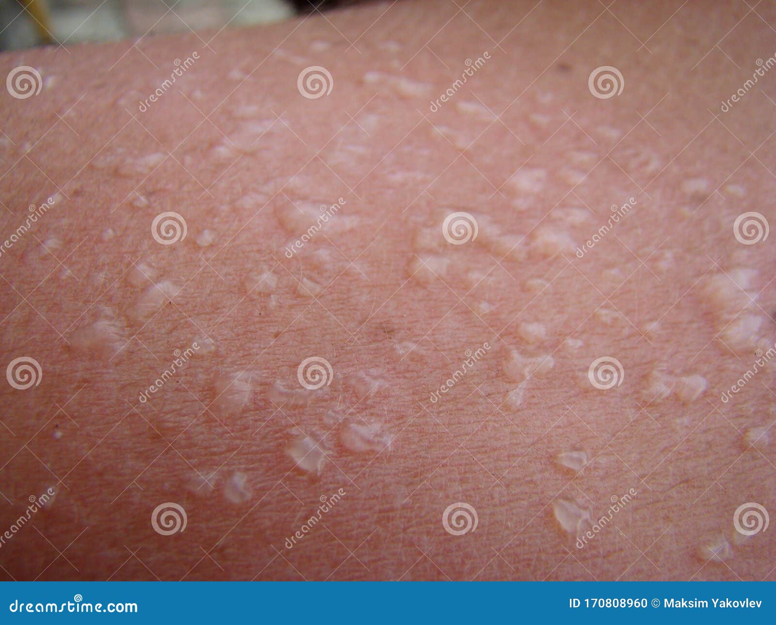 Sunburn stock photo. Image of sunbathe, sunburn, summer - 170808960