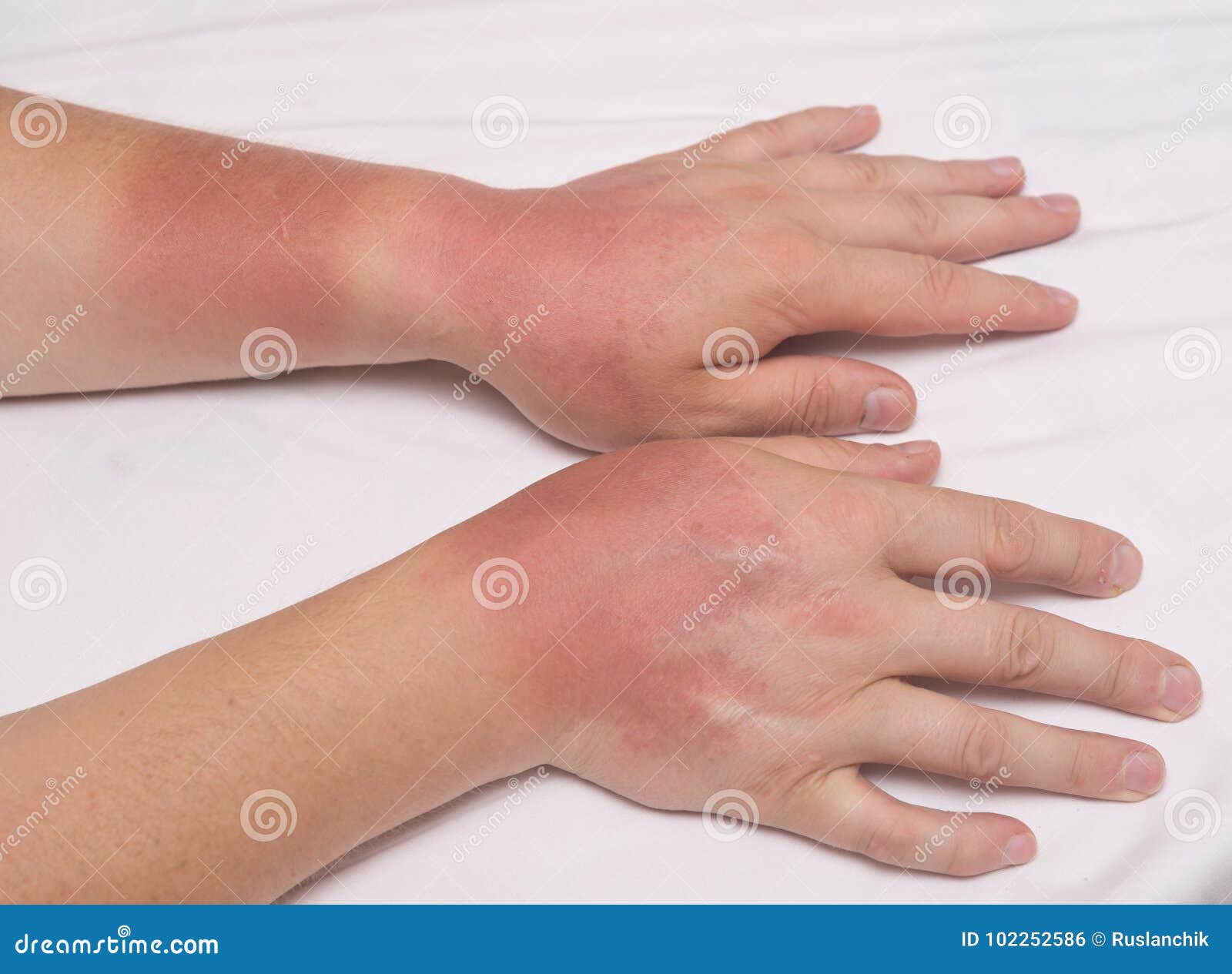 Sunburn stock photo. Image of burnt, burns, sunburn - 102252586