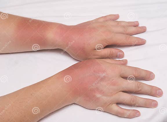Sunburn stock photo. Image of burnt, burns, sunburn - 102252586