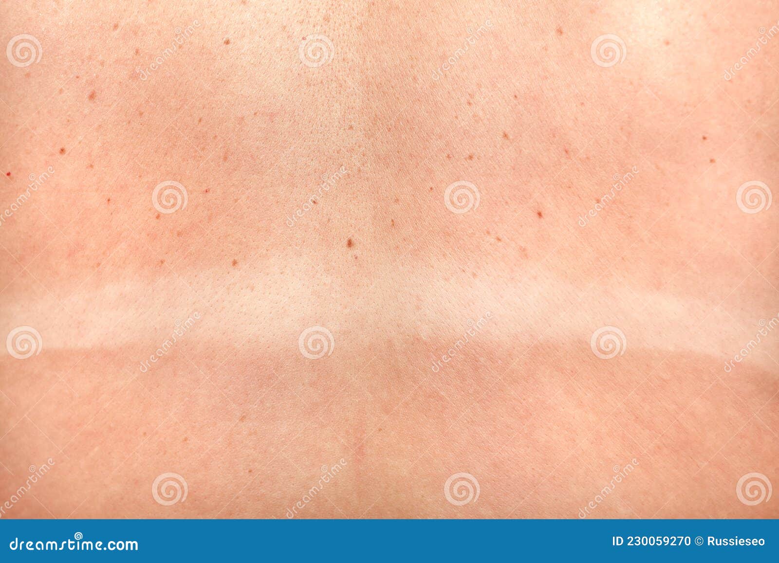 Sunburn mark on the back stock photo. Image of rough - 230059270