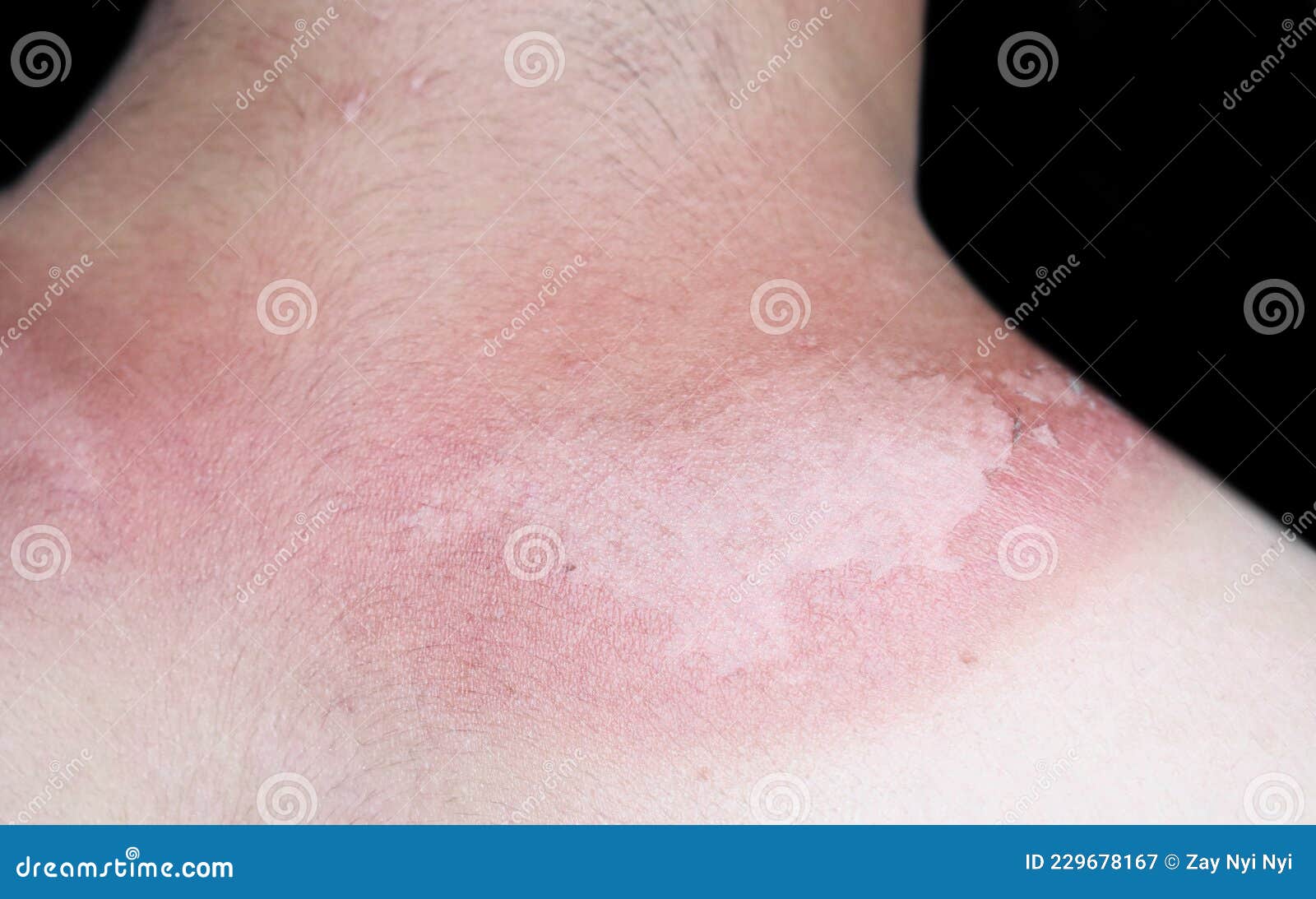 Sun Skin Discoloration Stock Photos - Free & Royalty-Free Stock Photos ...