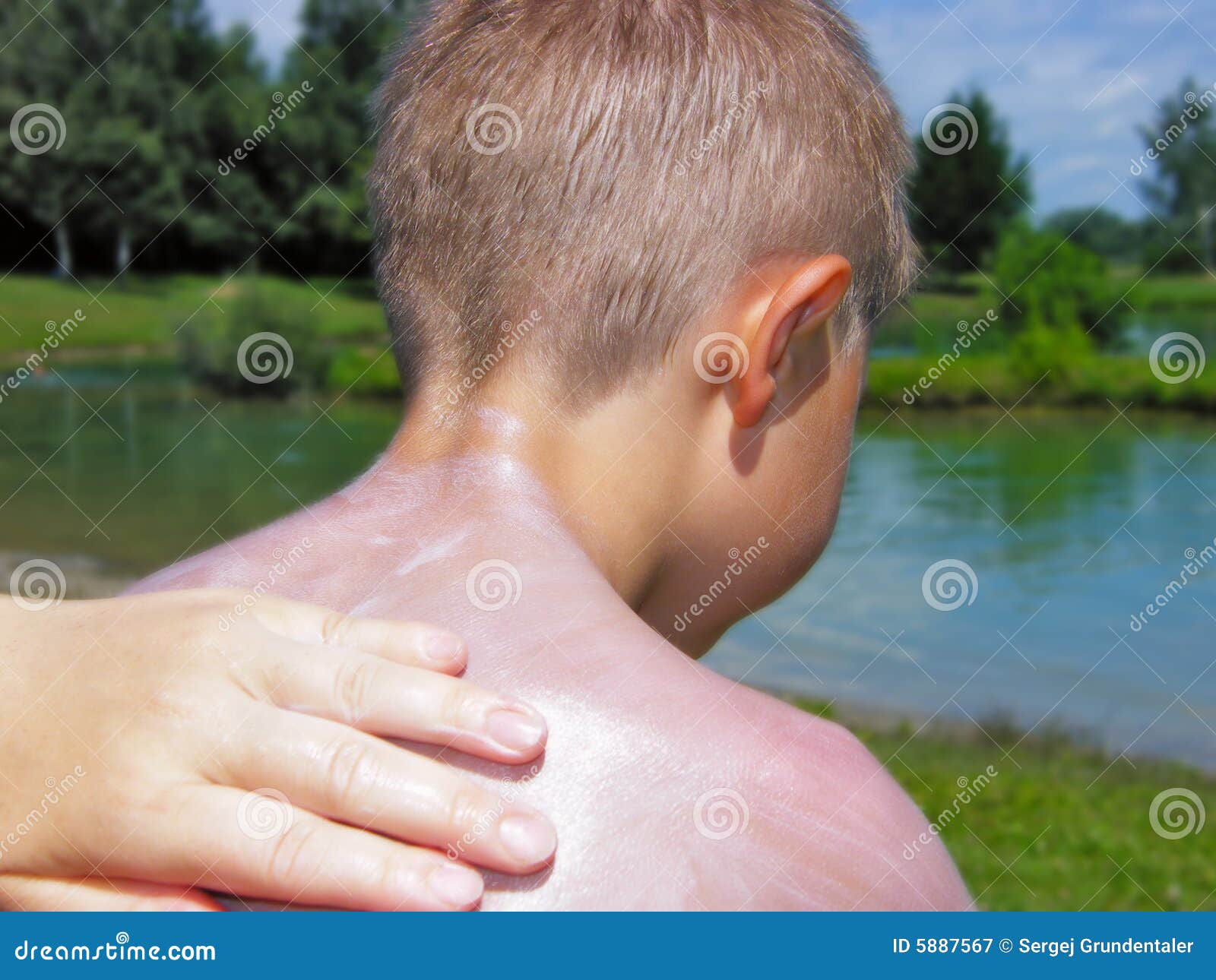 Sunburn protection stock image. Image of danger, child - 5887567