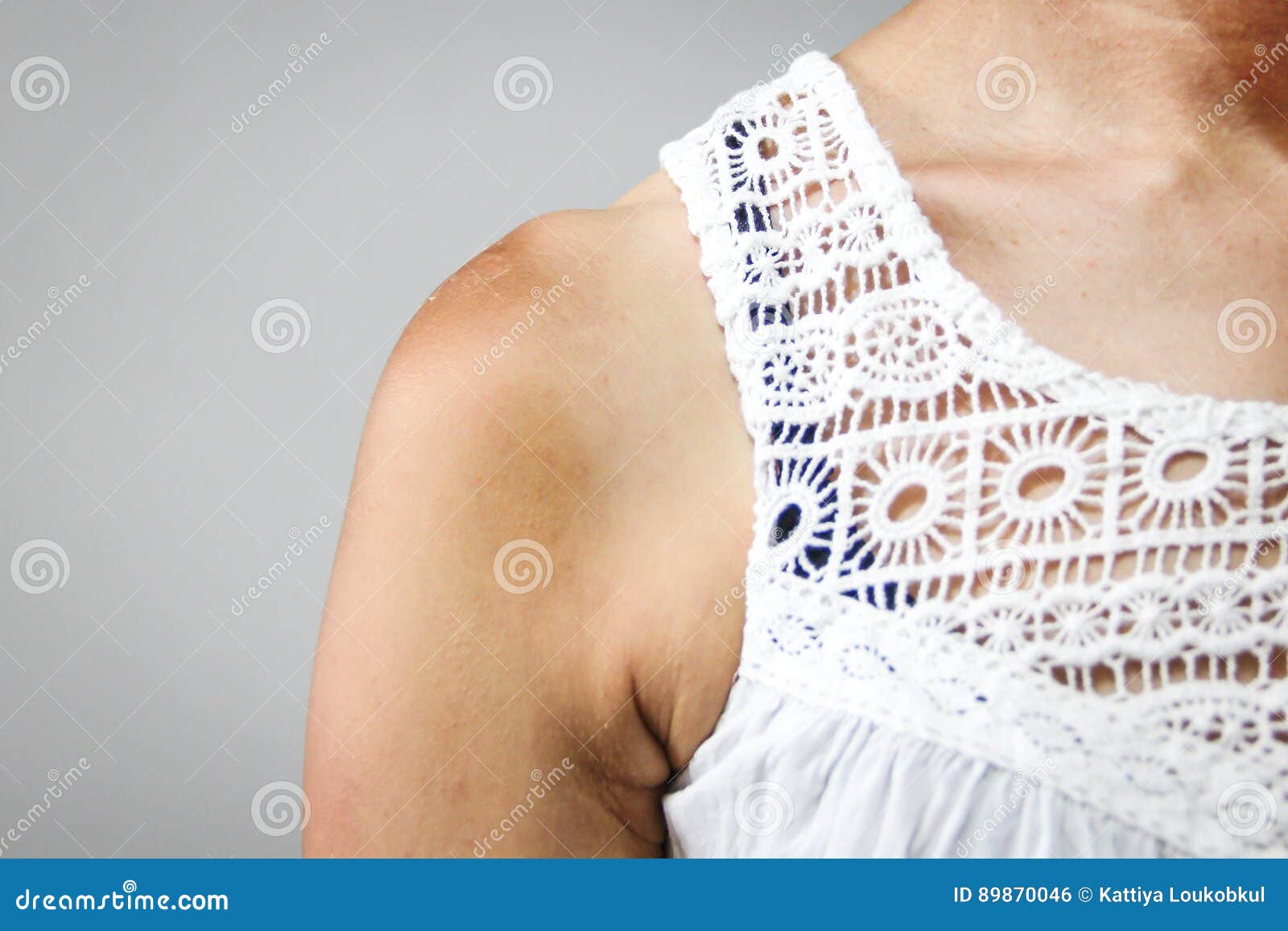 Sunburn shoulder stock photo. Image of sunburned, care - 89870046