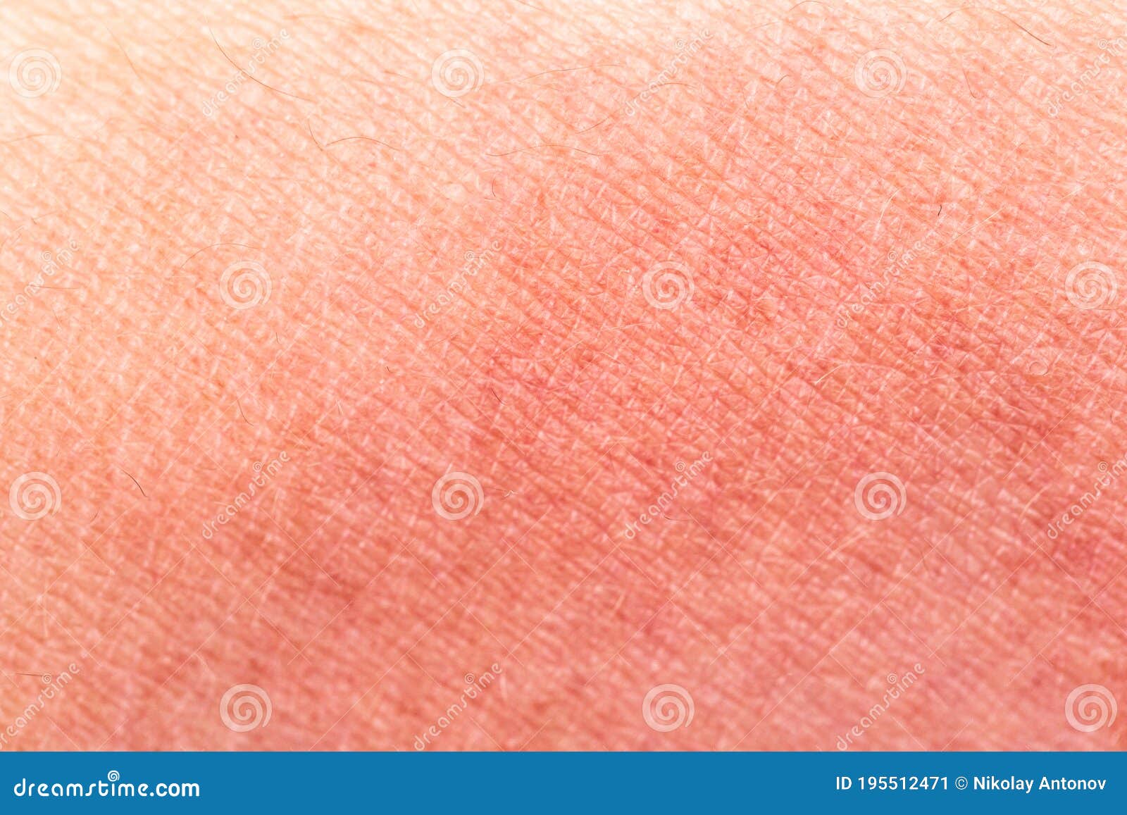Sunburn Skin As a Texture or Background. Selective Focus. Extreme Macro ...