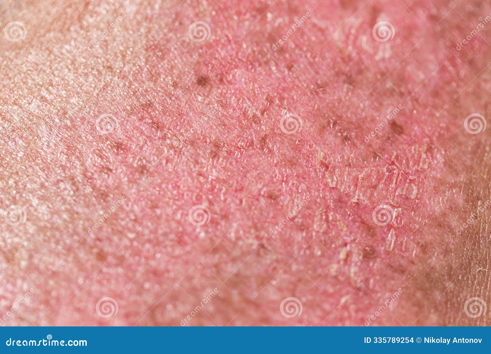Sunburn Skin Portrait Of Young Man Over Beach Background Stock ...