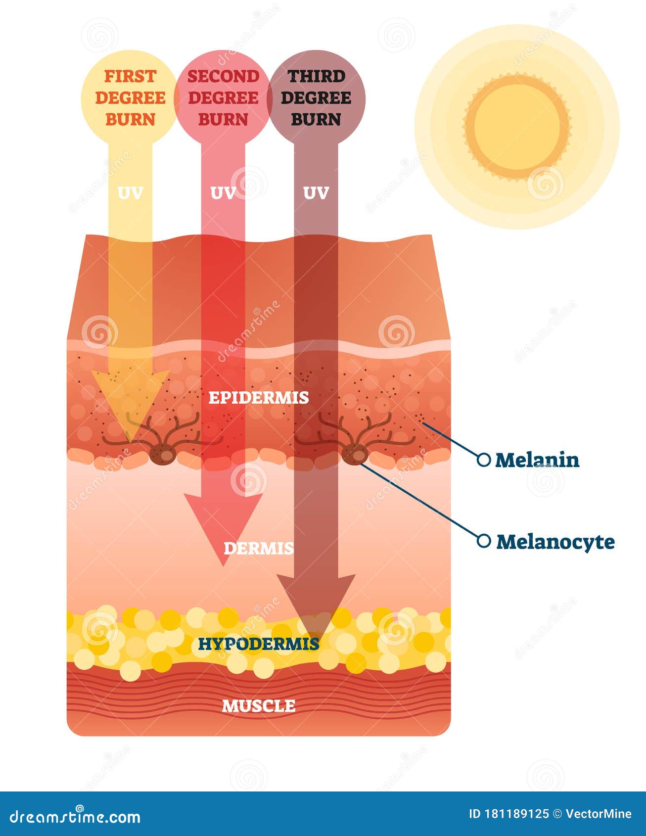 Sunburn Cartoons Illustrations And Vector Stock Images 6019 Pictures
