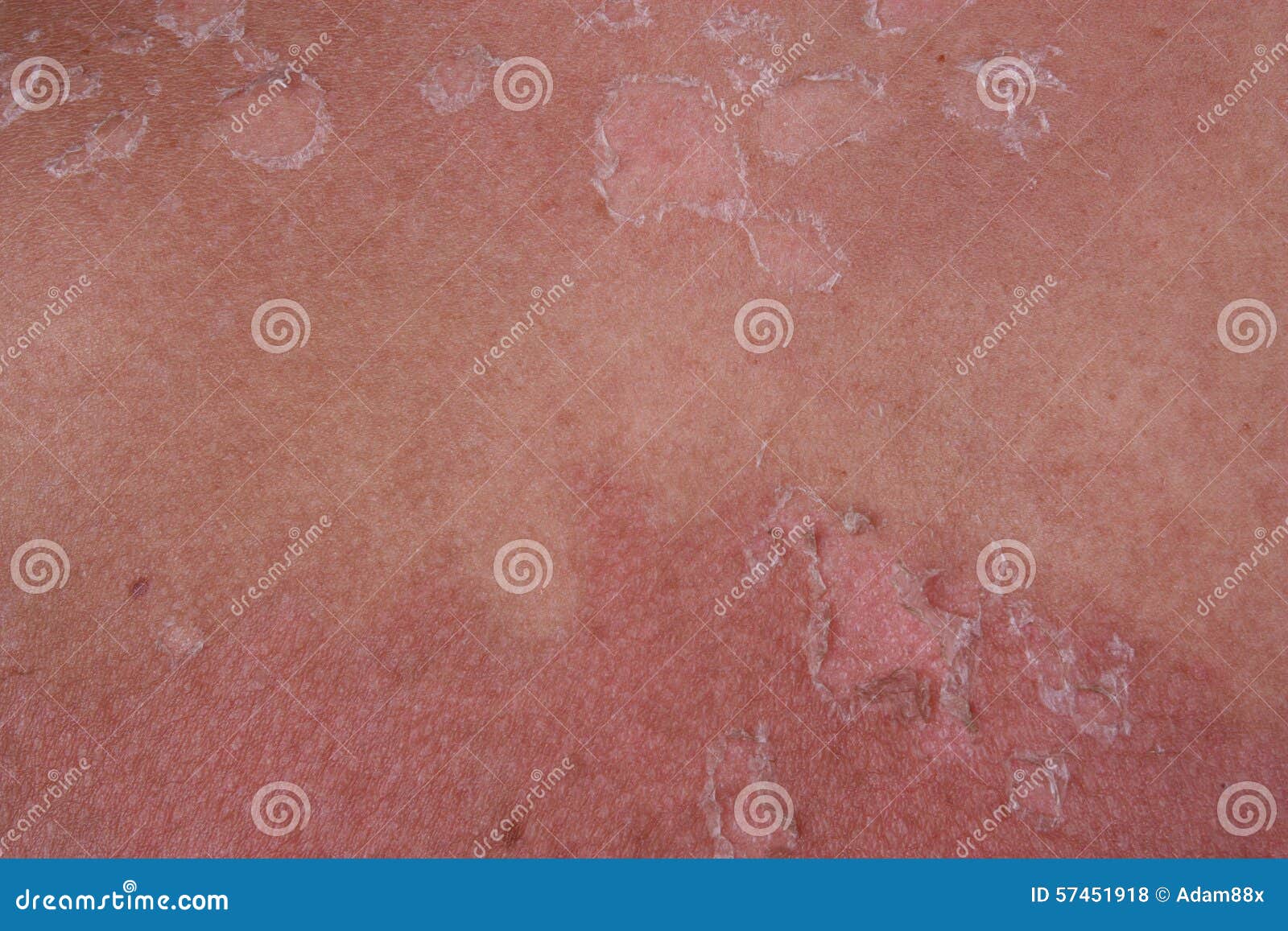 Sunburn skin stock photo. Image of cancer, protect, pattern - 57451918
