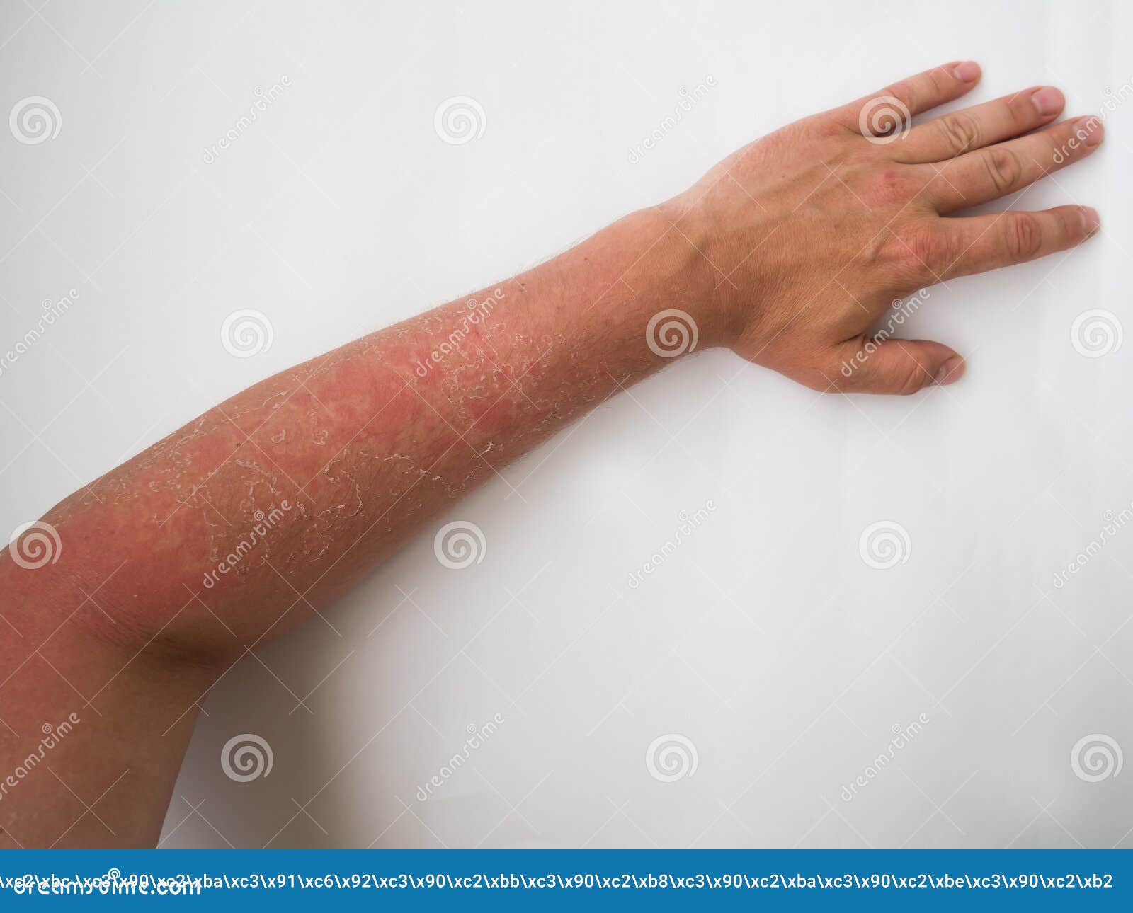 Sunburn on the skin stock image. Image of body, caucasian - 221055415