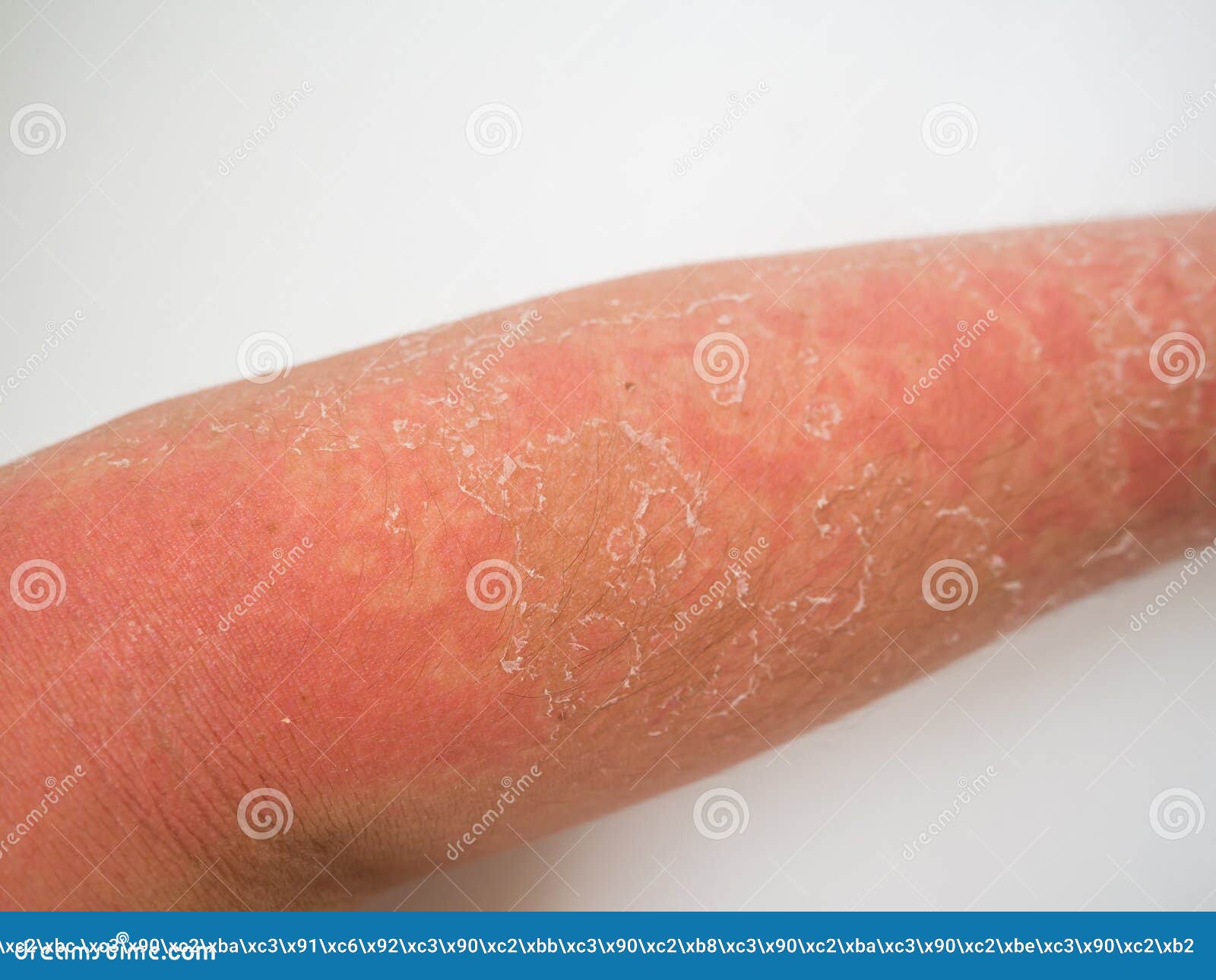 Sunburn on the skin stock image. Image of solarium, dermatology - 221055417