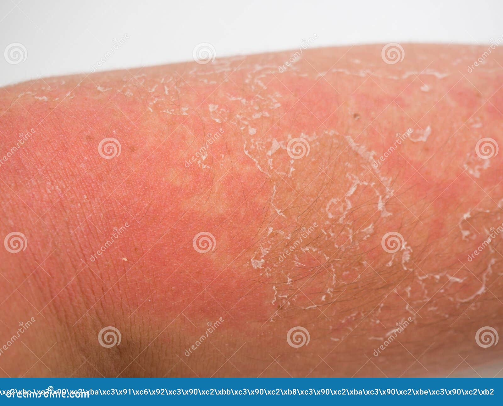 Sunburn on the skin stock photo. Image of male, damage - 221055422