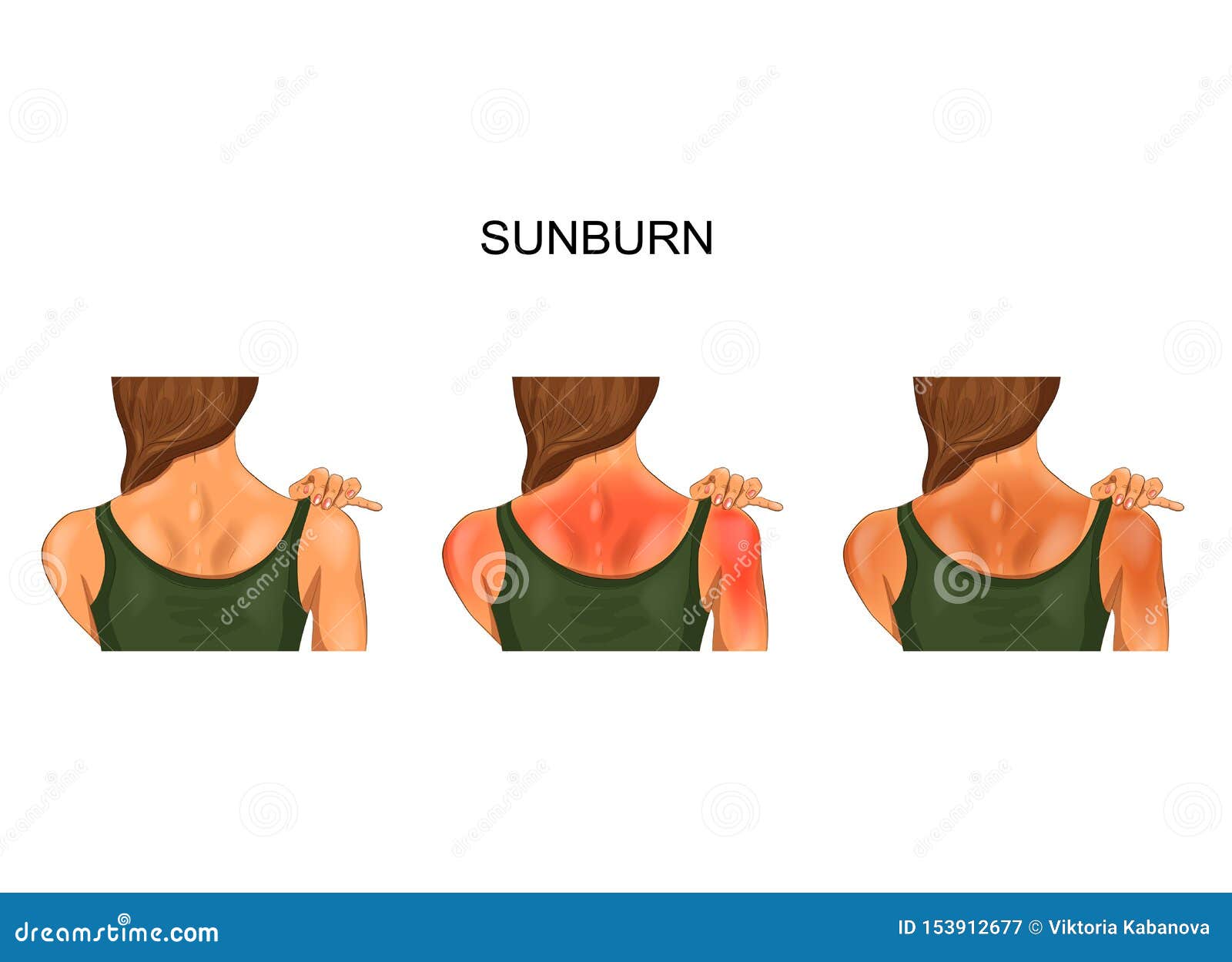 Sunburn of the skin stock vector. Illustration of dispersed - 153912677