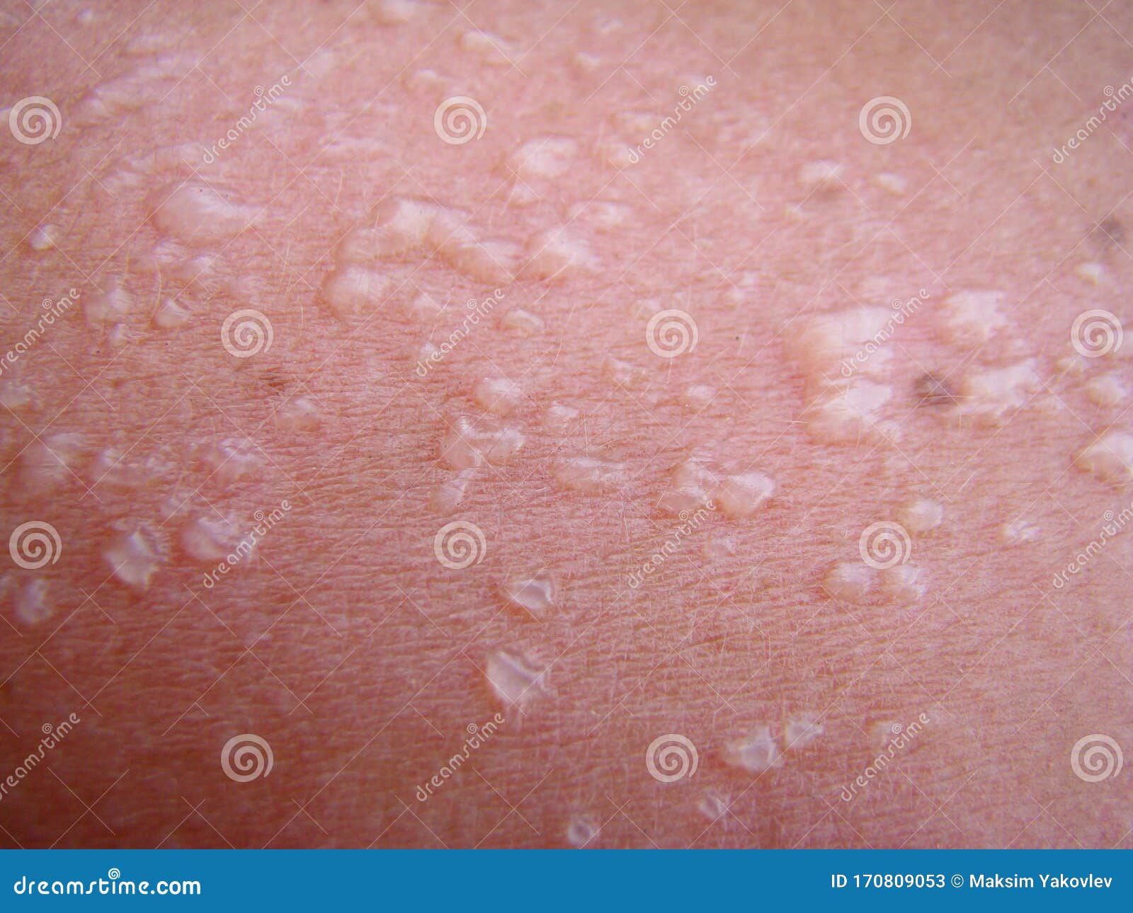 Sunburn stock image. Image of burn, sunscreen, blisters - 170809053