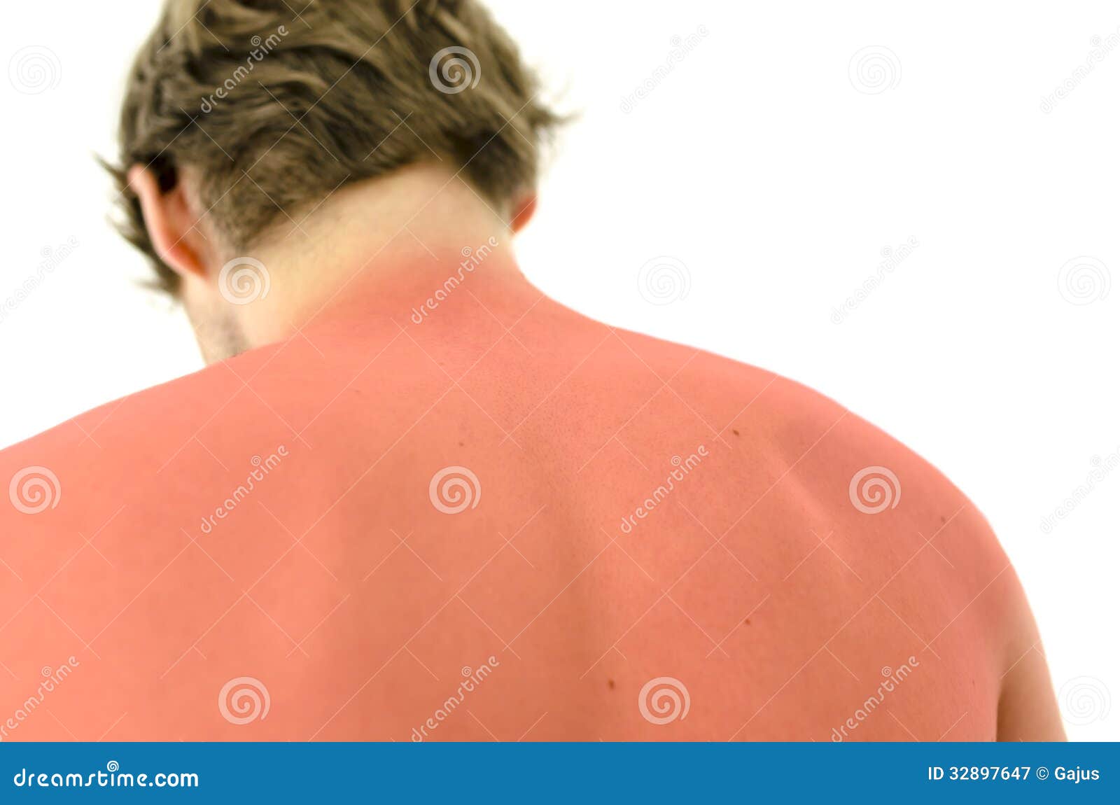 Sunburn Royalty Free Stock Photography - Image: 32897647