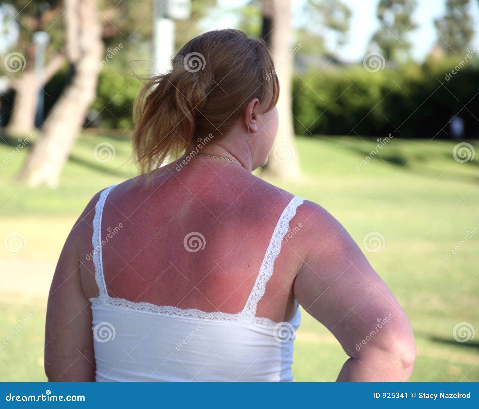 Sunburn Woman Stock Image Image Of Heat Necklace Grass 925341