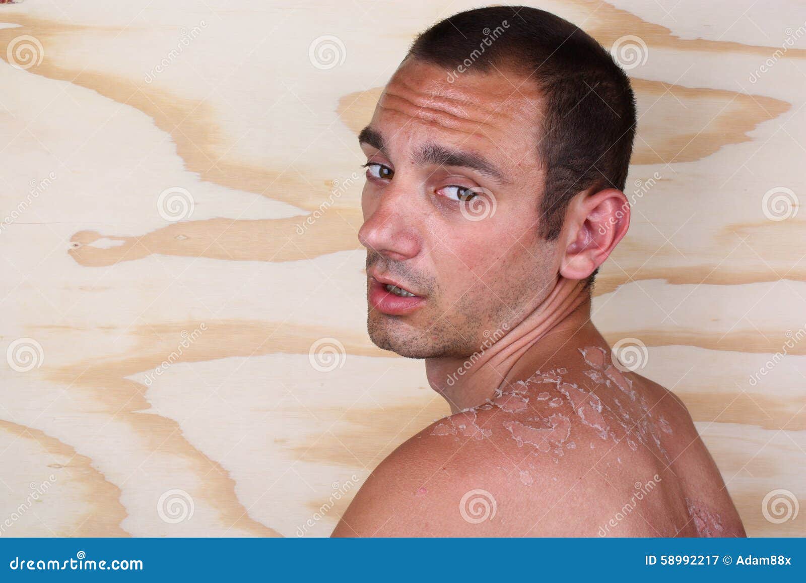 Sunburned back body stock image. Image of cancer, irritated - 58992217