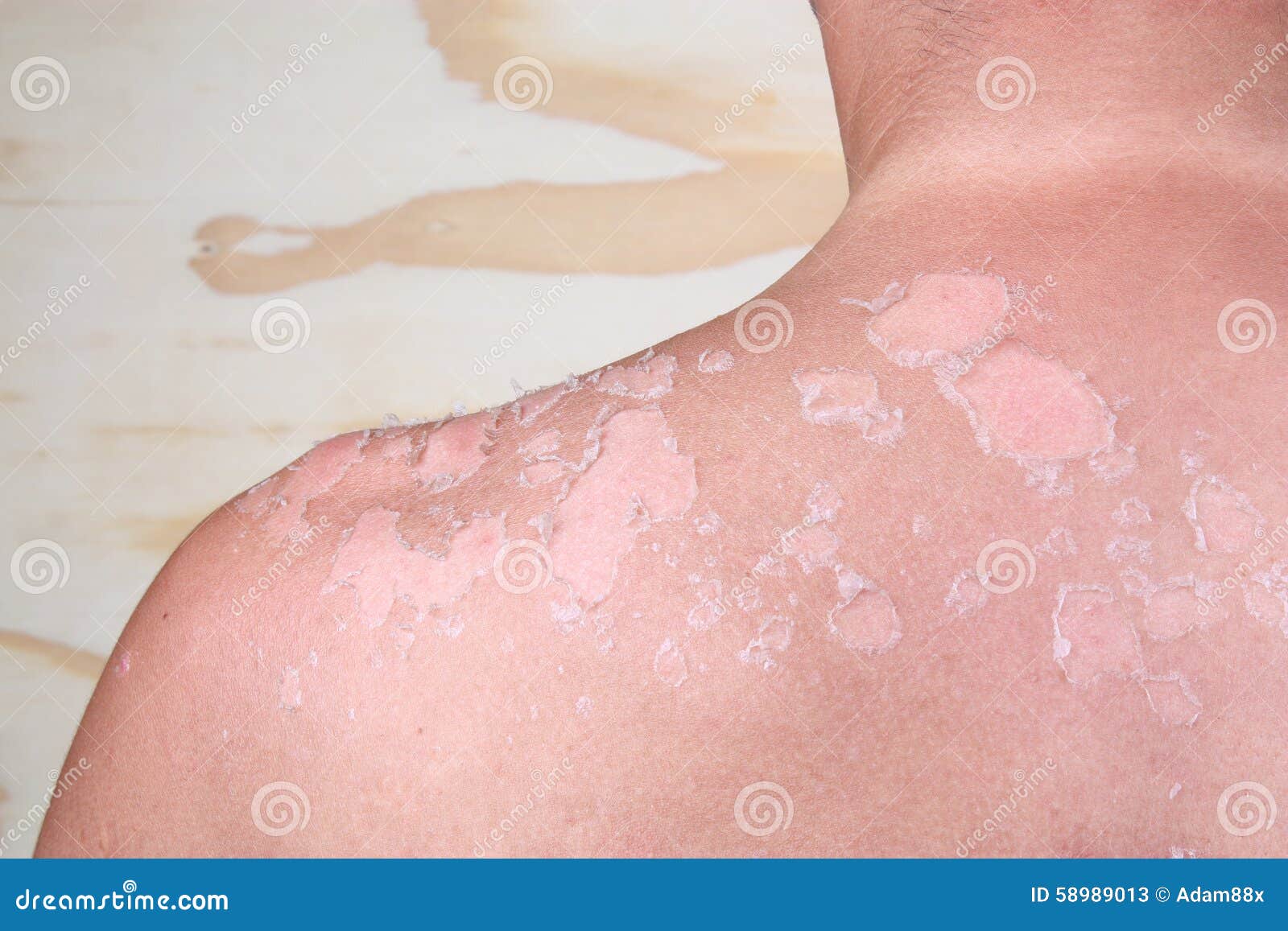 Sunburned back stock image. Image of healthy, caucasian - 58989013